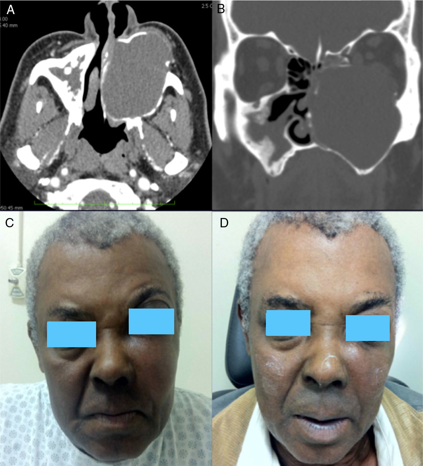 maxillary sinus bone loss