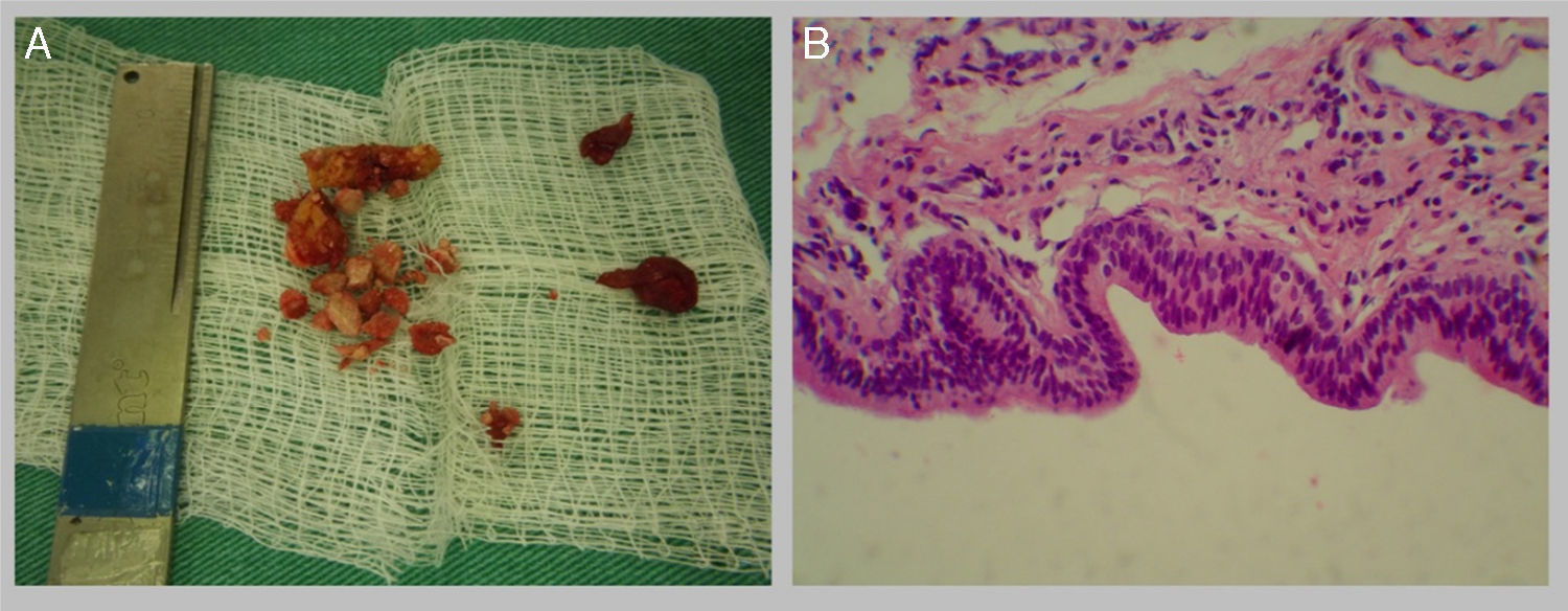 Giant sialolith of submandibular gland duct treated by excision and ...
