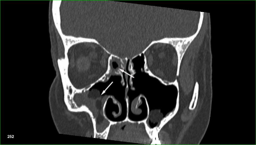 Sinusitis in patients undergoing allogeneic bone marrow transplantation ...