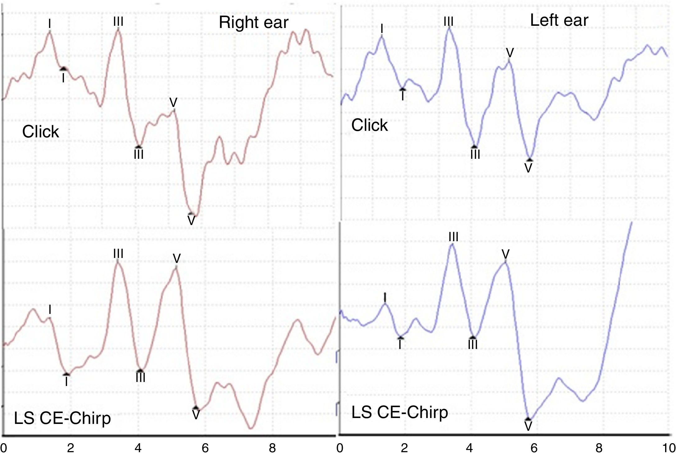LS CE-Chirp® vs. Click in the neuroaudiological diagnosis by ABR ...