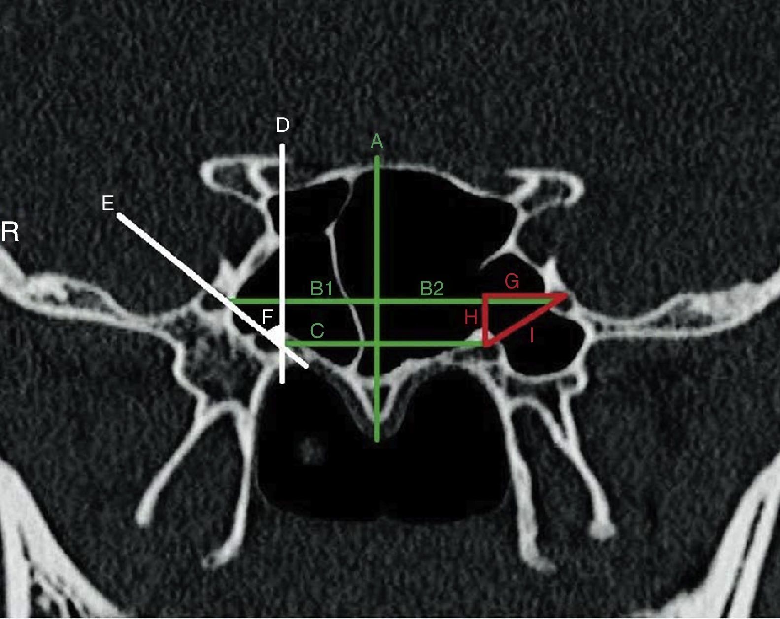 The sphenoid sinus, foramen rotundum and vidian canal: a radiological ...
