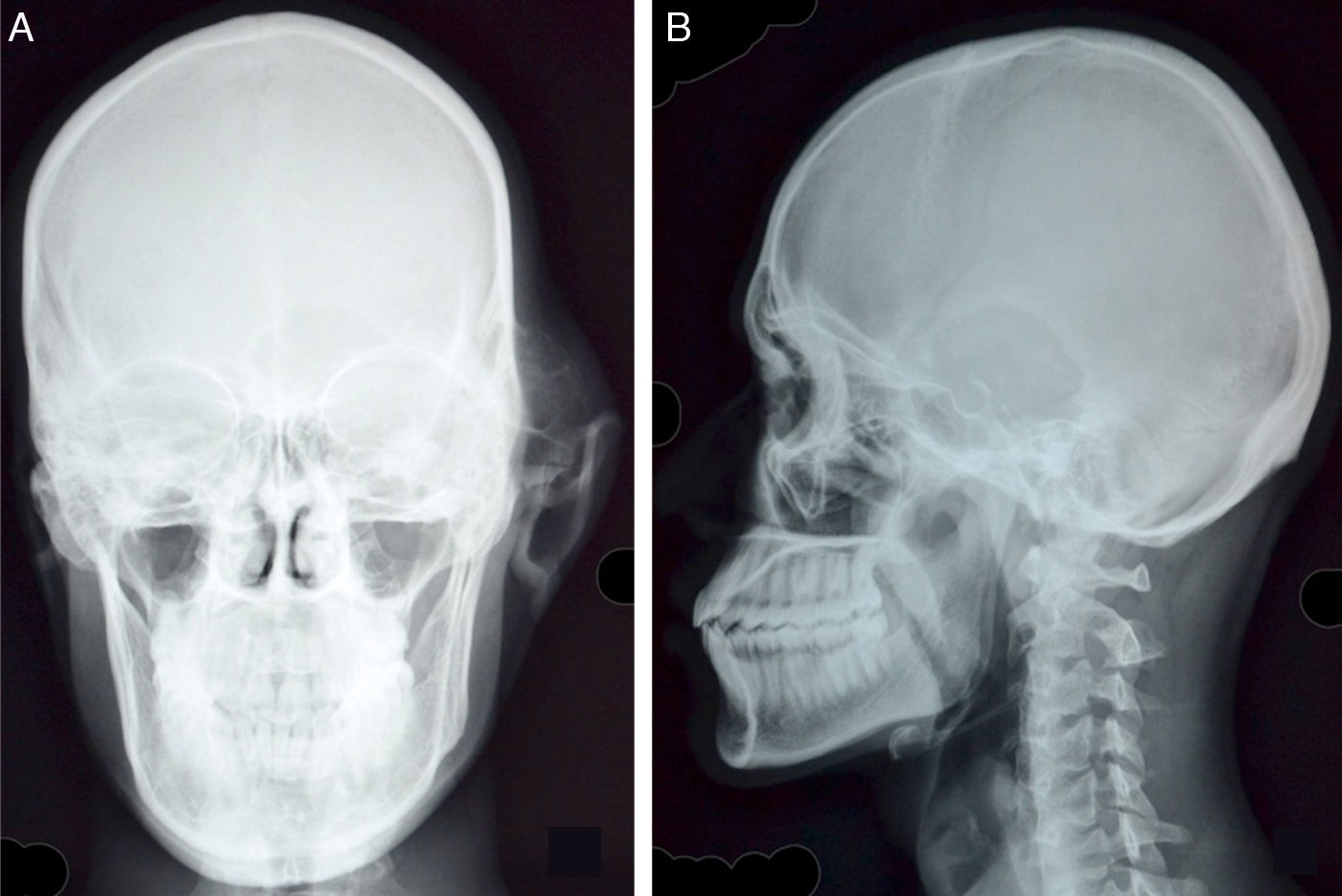 temporal bone problems