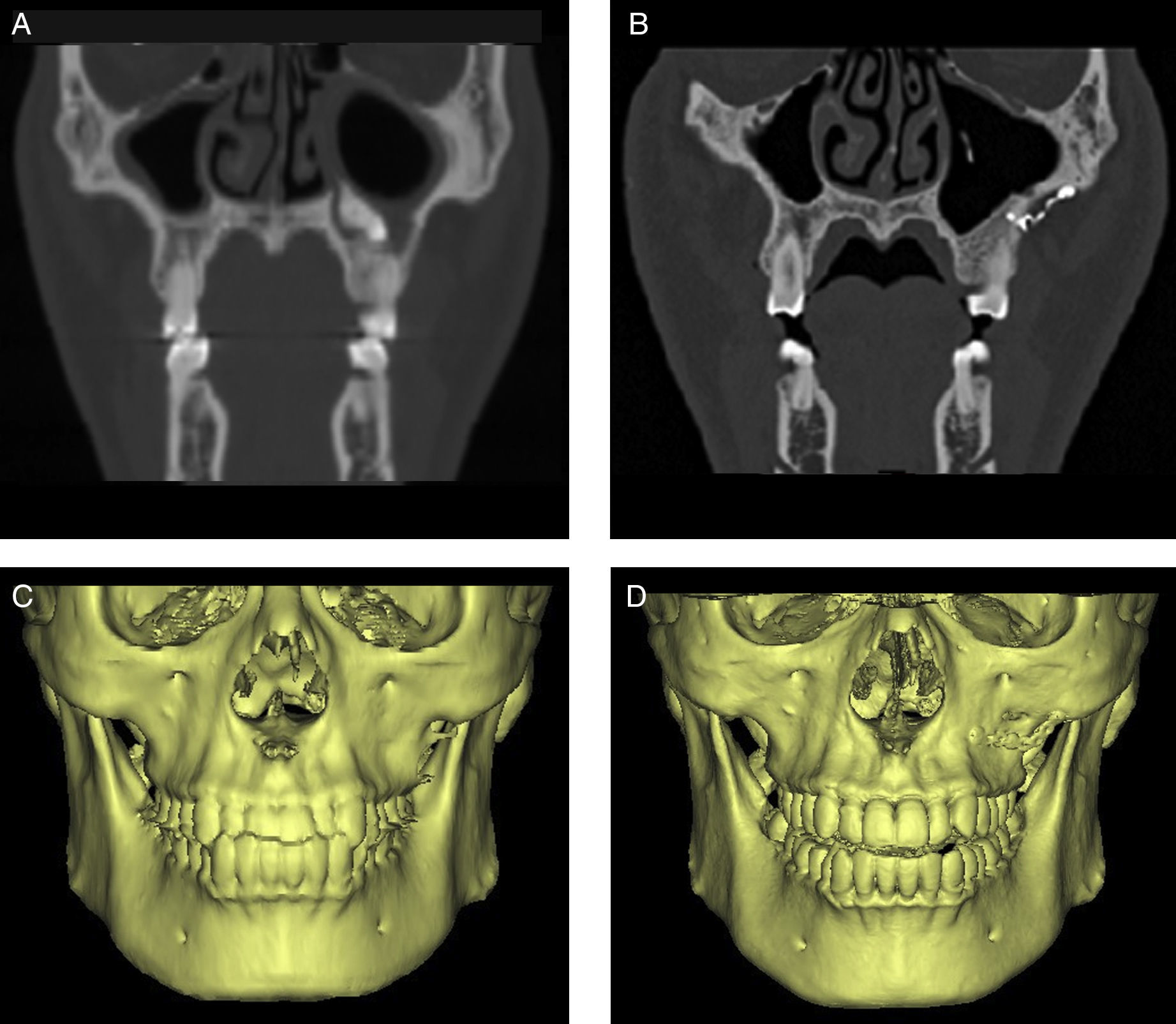 Digital design of functional surgery for odontogenic cyst intruding ...