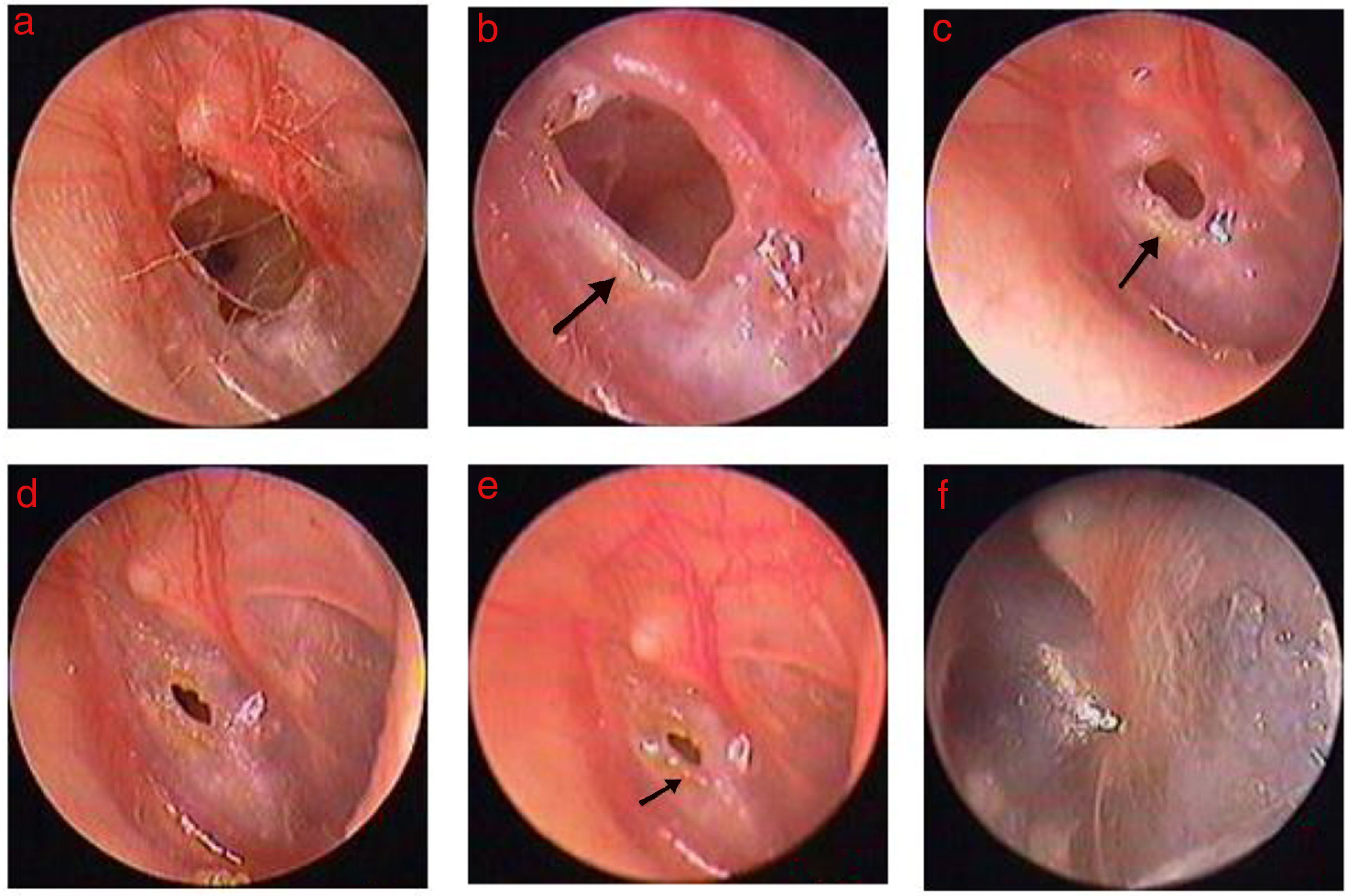 tympanic membrane perforation