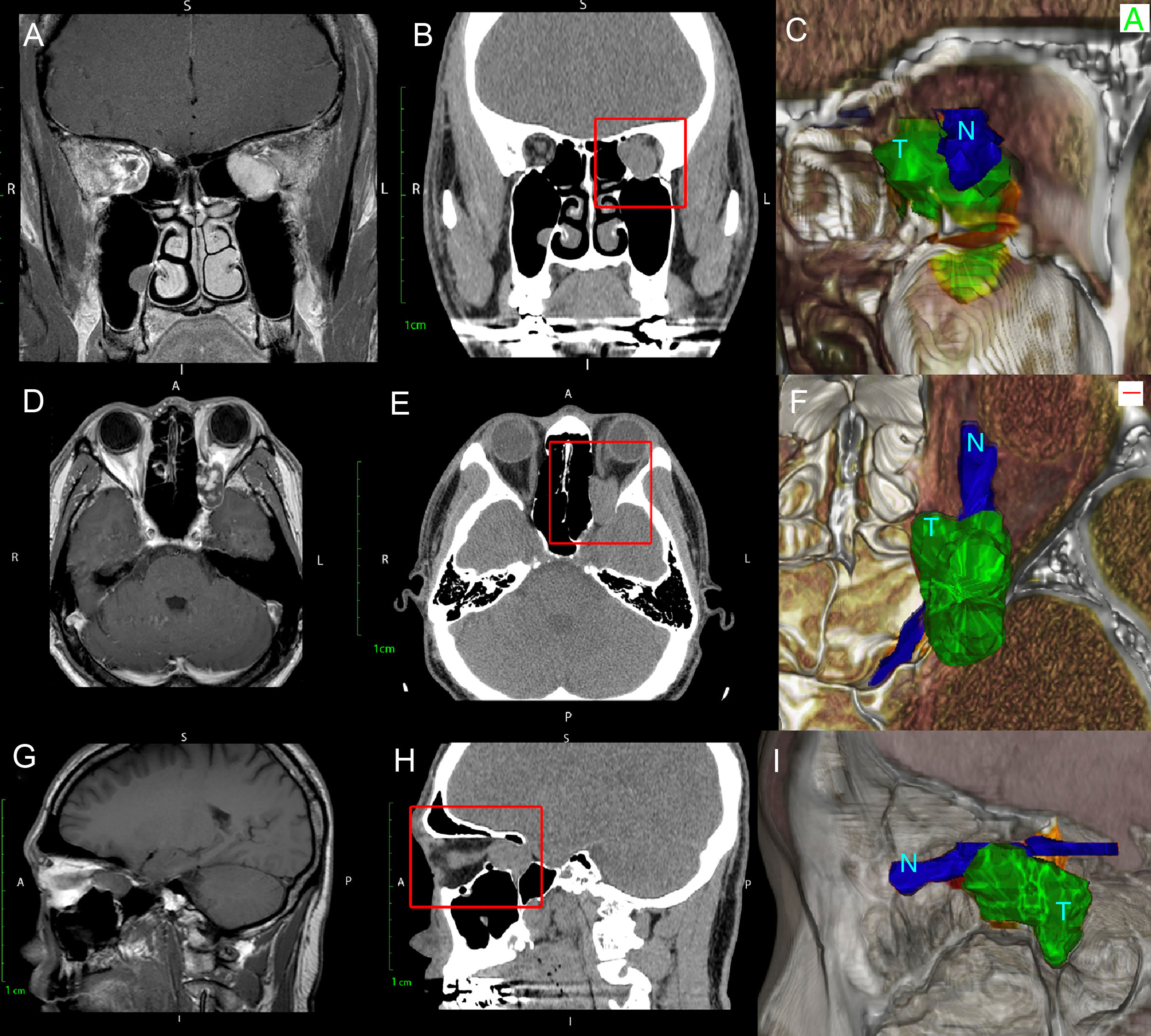 Expanding the limits of endoscopic intraorbital tumor resection using 3 ...