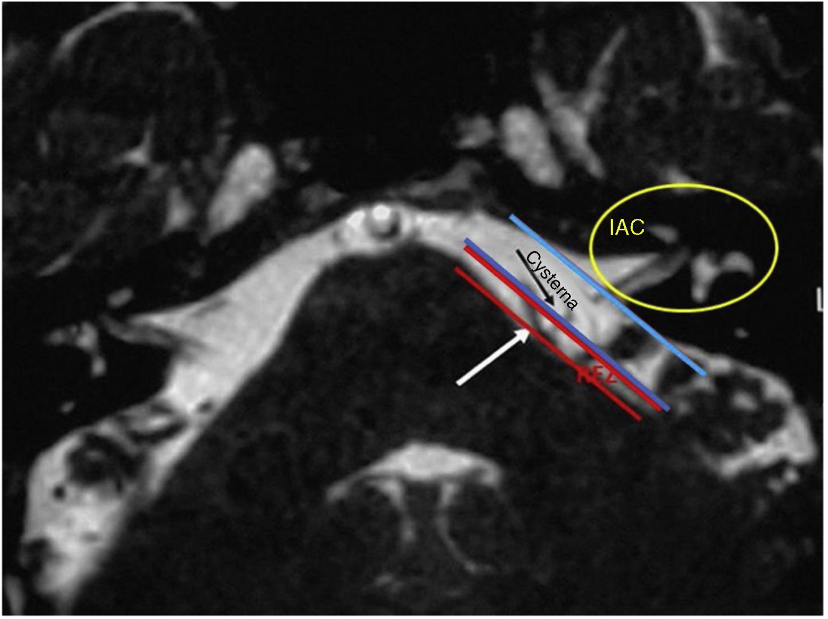 Endoscope-assisted retrosigmoid approach in hemifacial spasm: our ...