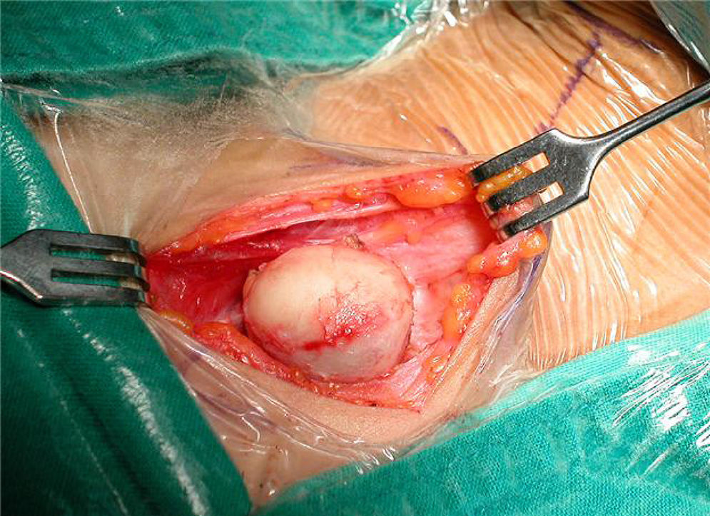 epidermoid cyst