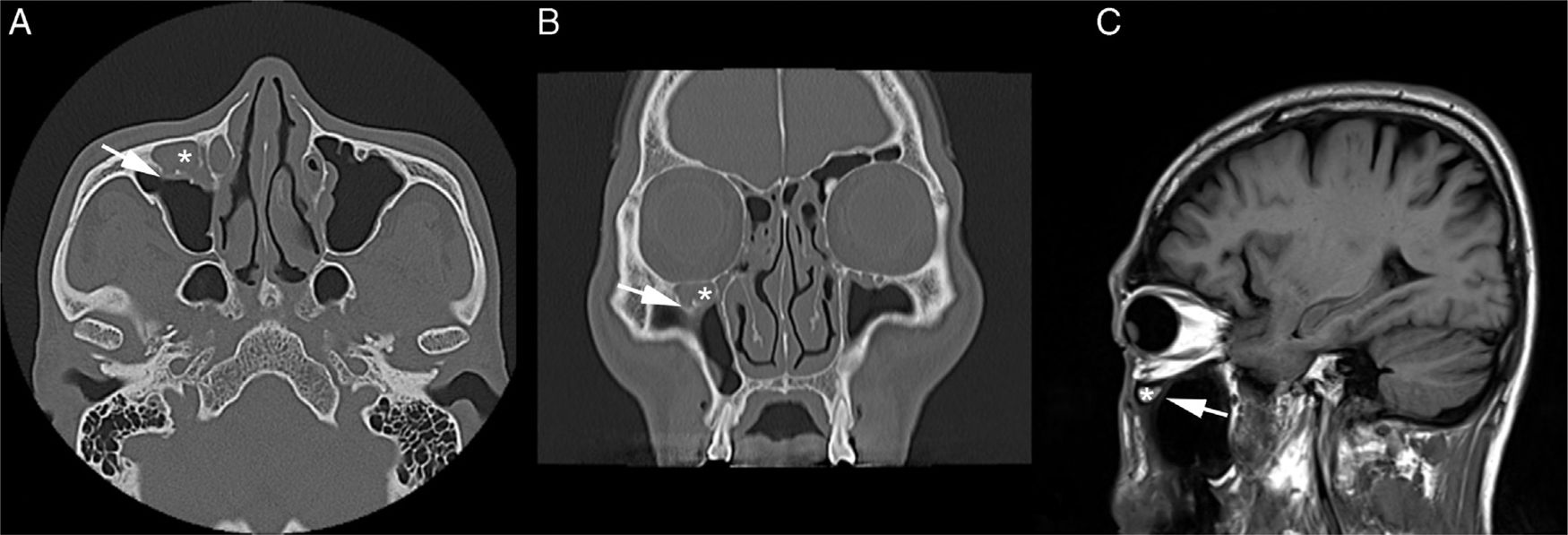 Hypoesthesia of midface by isolated Haller's cell mucocele | Brazilian ...