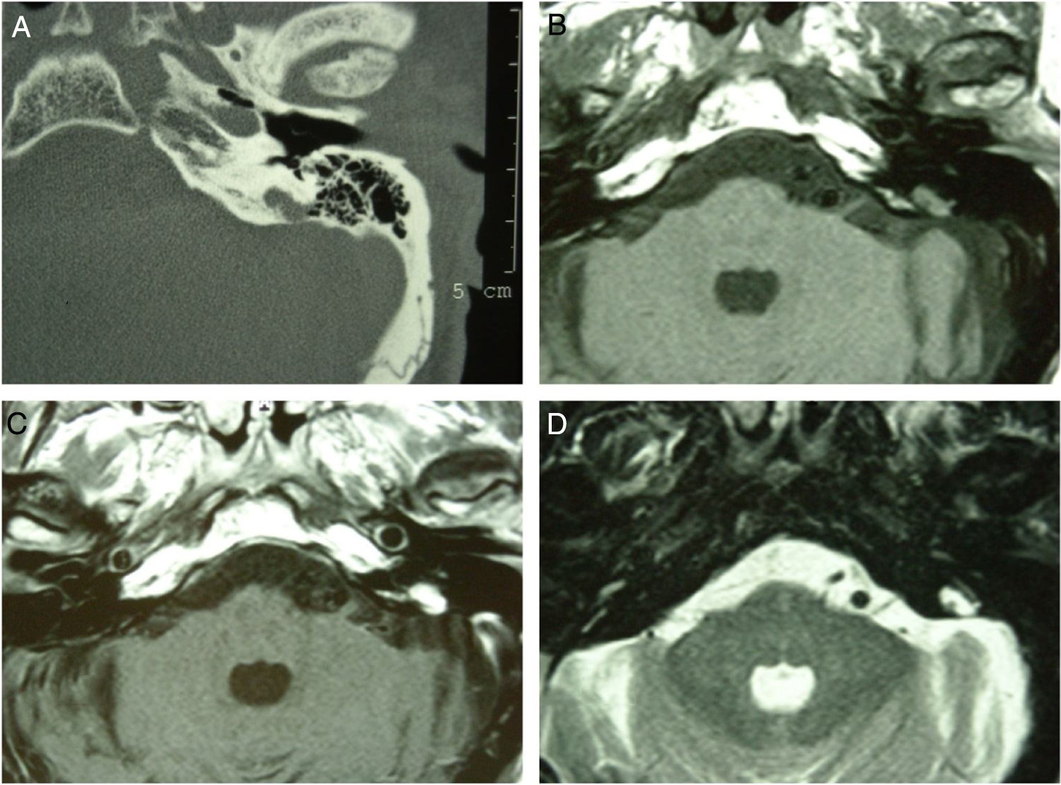 endolymphatic sac decompression els