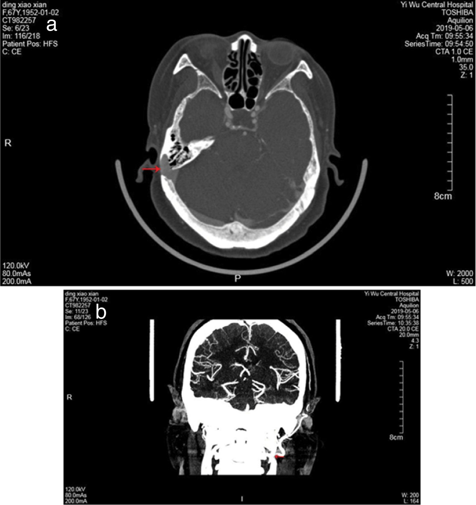 The styloid process and the formation of sigmoid sinus diverticulum: is ...