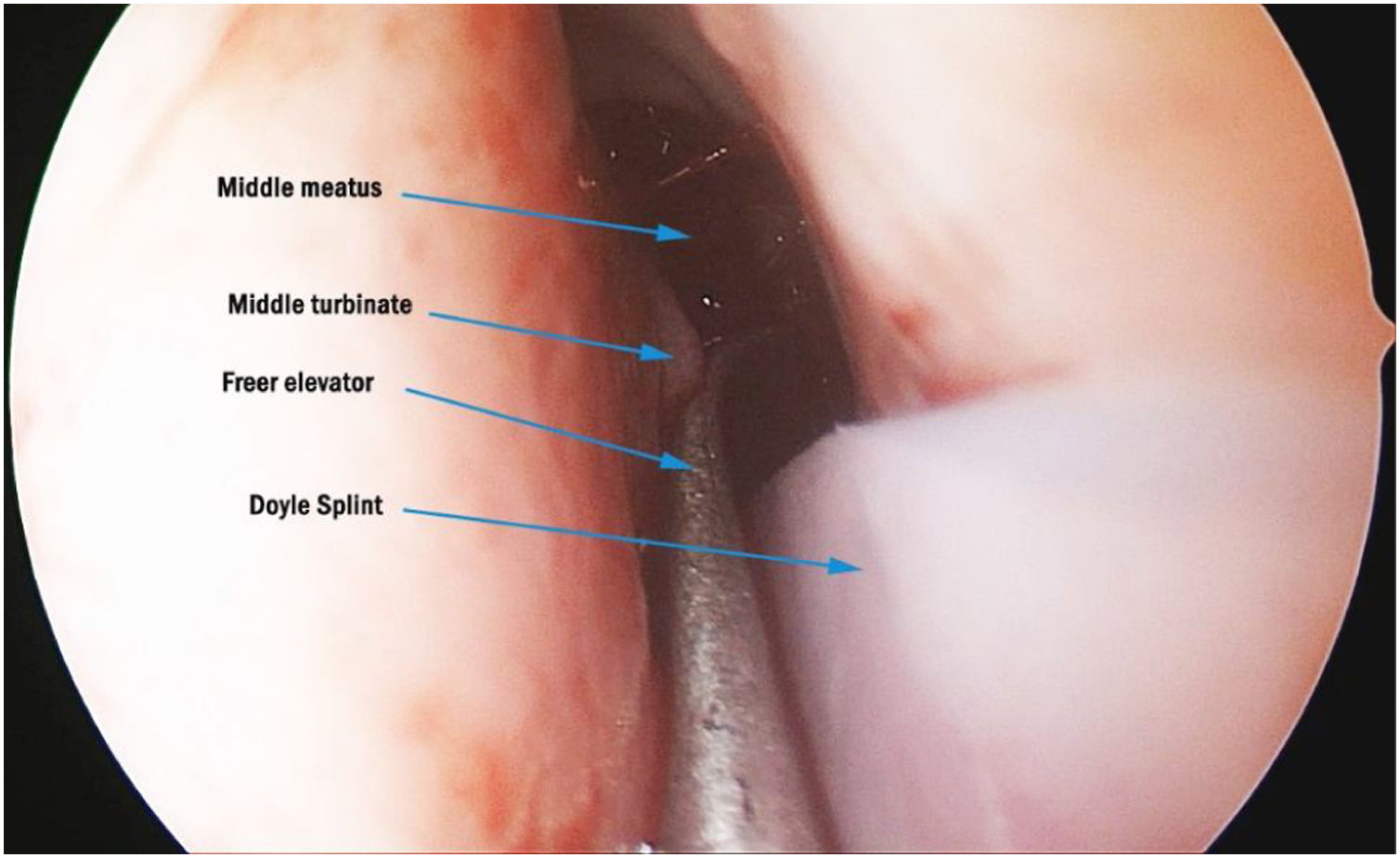 doyle nasal splints