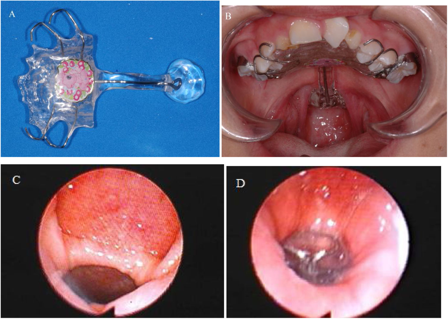 velopharyngeal dysfunction speech therapy