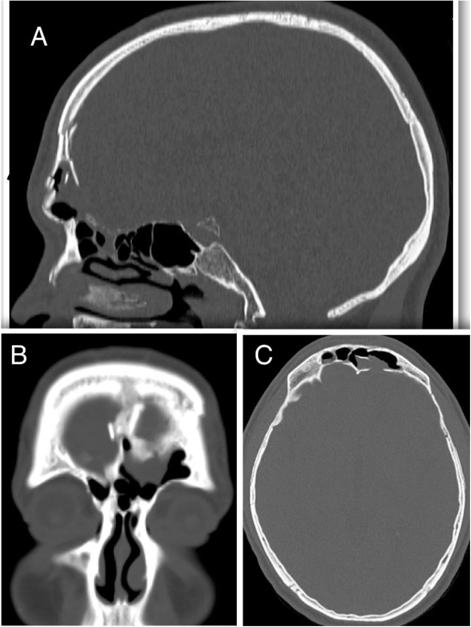 frontal sinus skull base