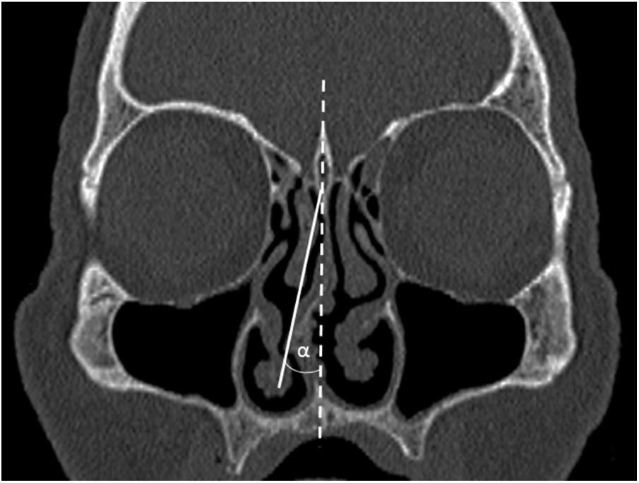 nasal septum anatomy ct