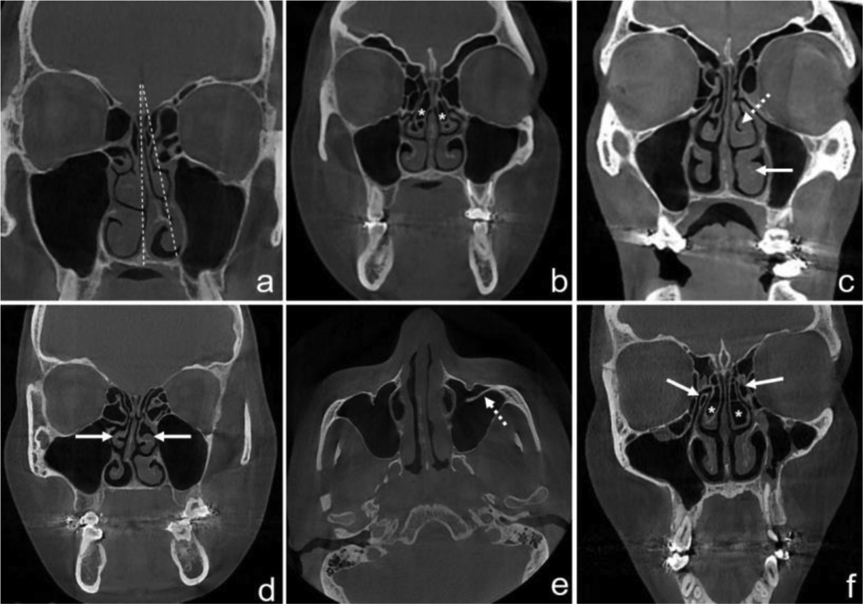 maxillary sinus bone spur