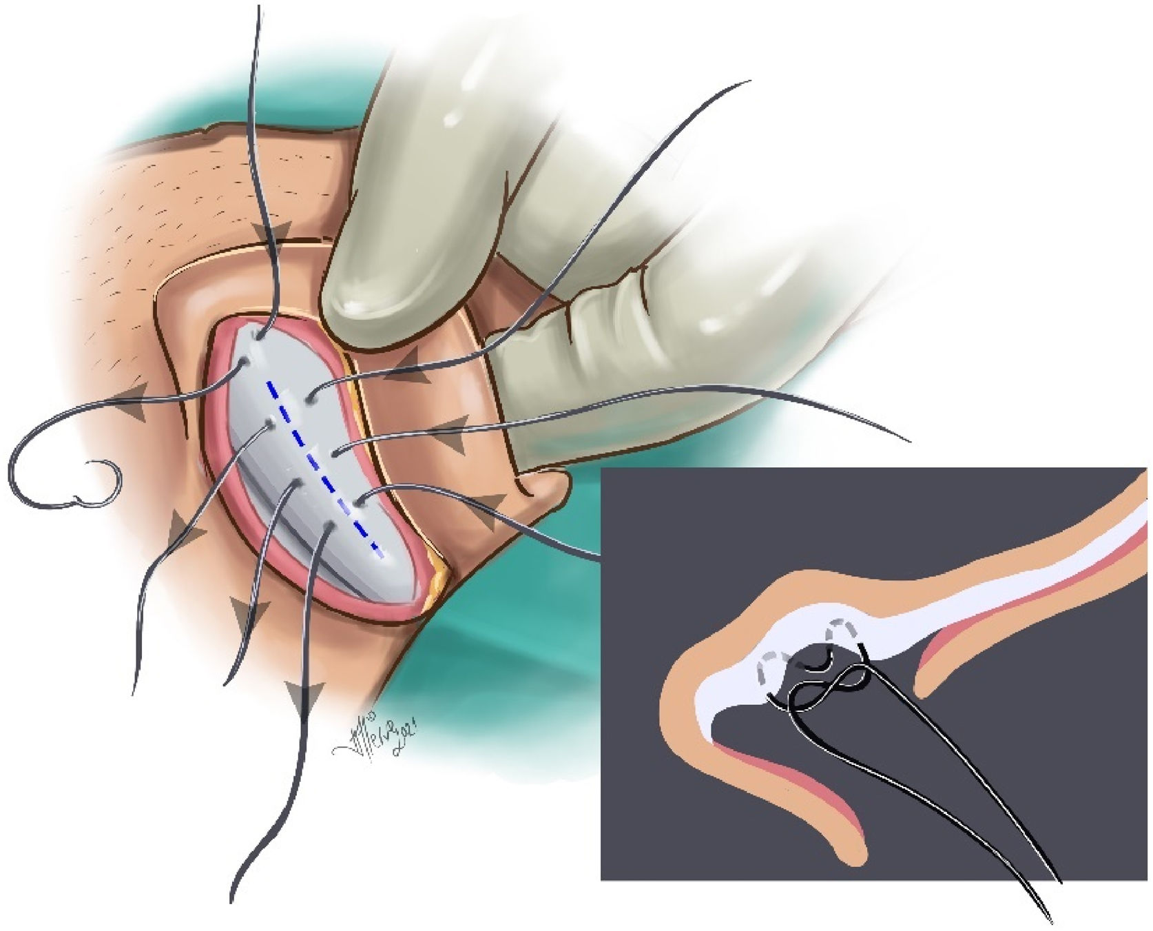 mustarde flap marking