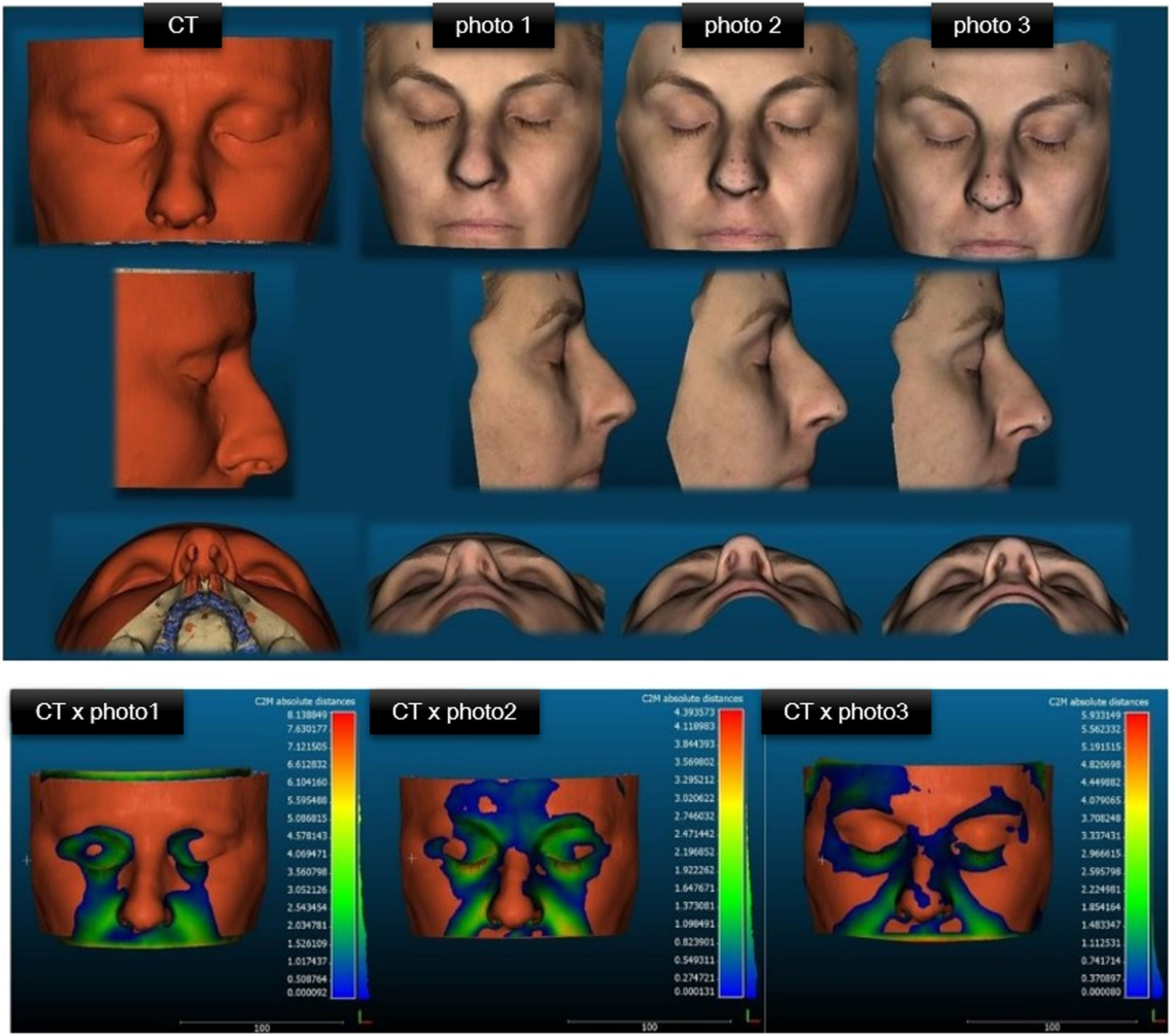 Protocol for capturing 3D facial meshes for rhinoseptoplasty planning ...