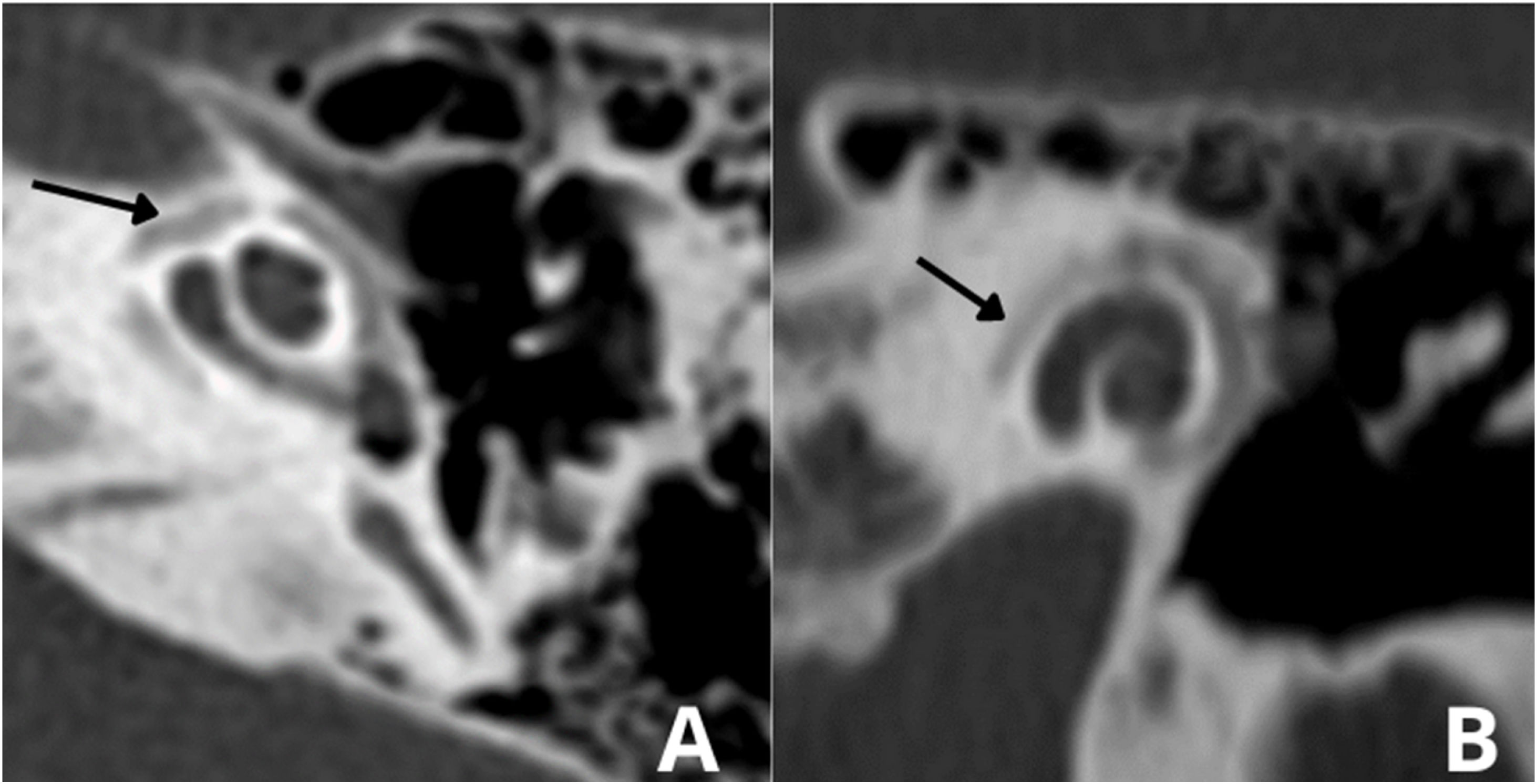 Brazilian Society of Otology task force – Otosclerosis: evaluation and ...