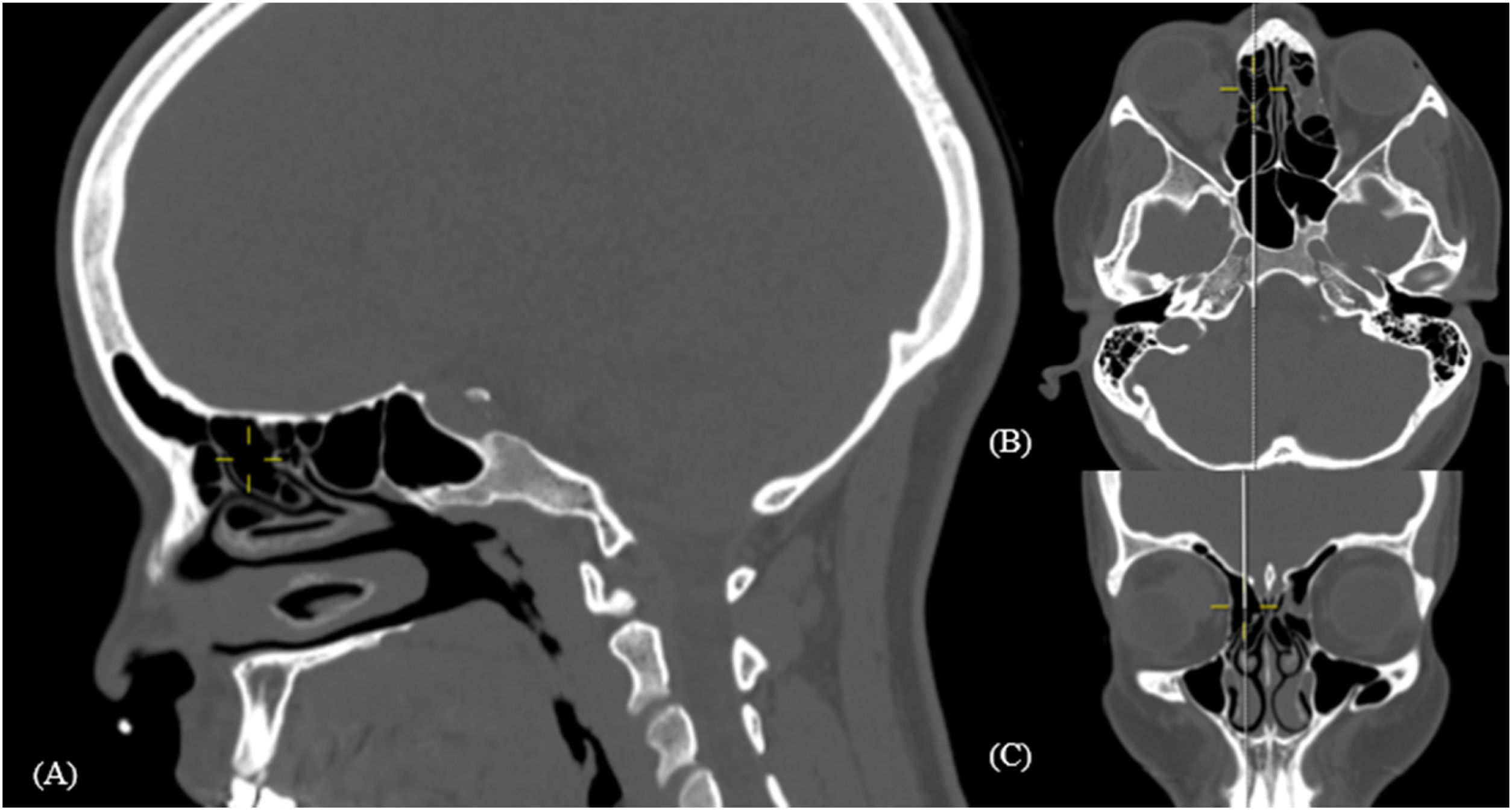 International Frontal Sinus Anatomy Classification (IFAC): evaluation ...
