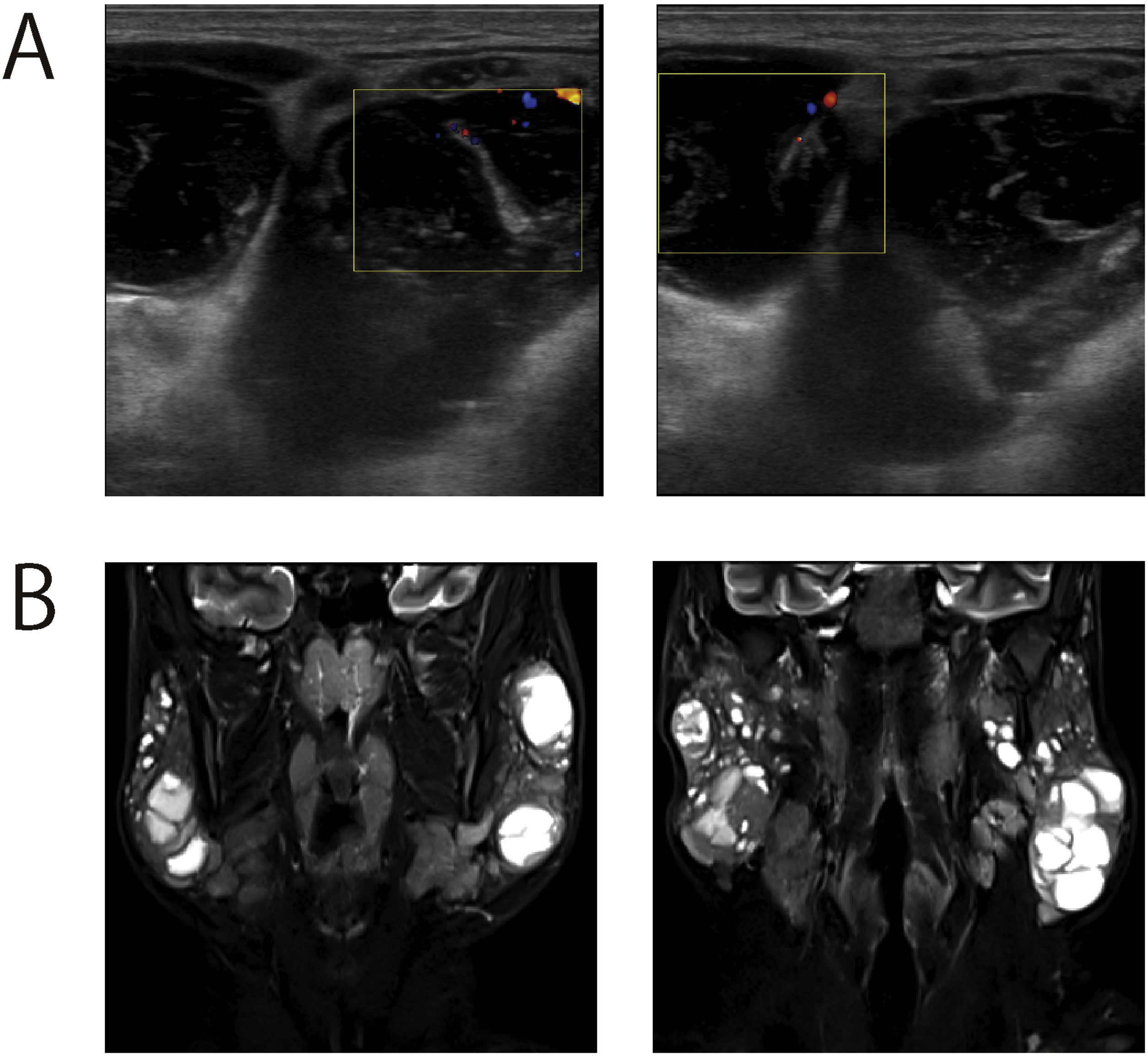 Human immunodeficiency virus-positive patients with parotid gland ...