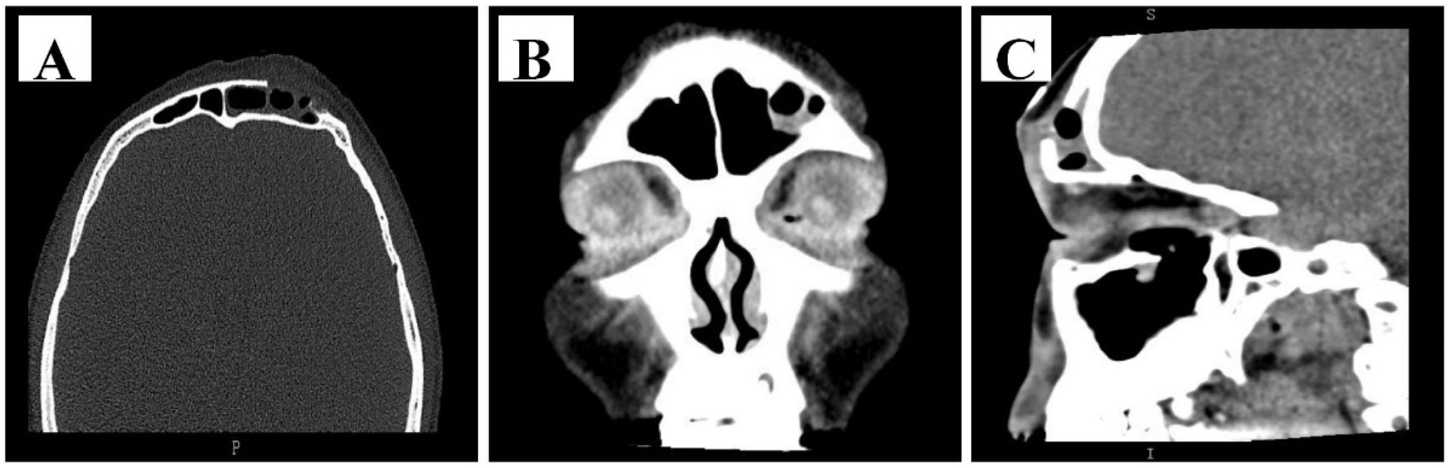 Ossifying hemangioma of the frontal sinus: a case report | Brazilian ...
