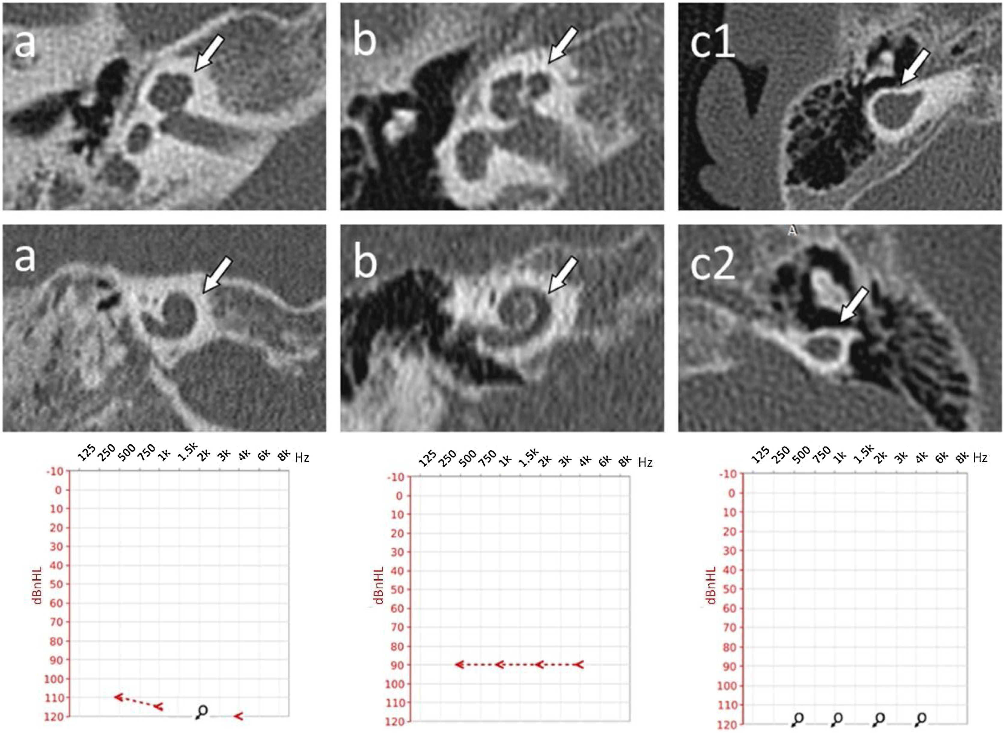 Detailed analysis of inner ear malformations in CHARGE syndrome ...