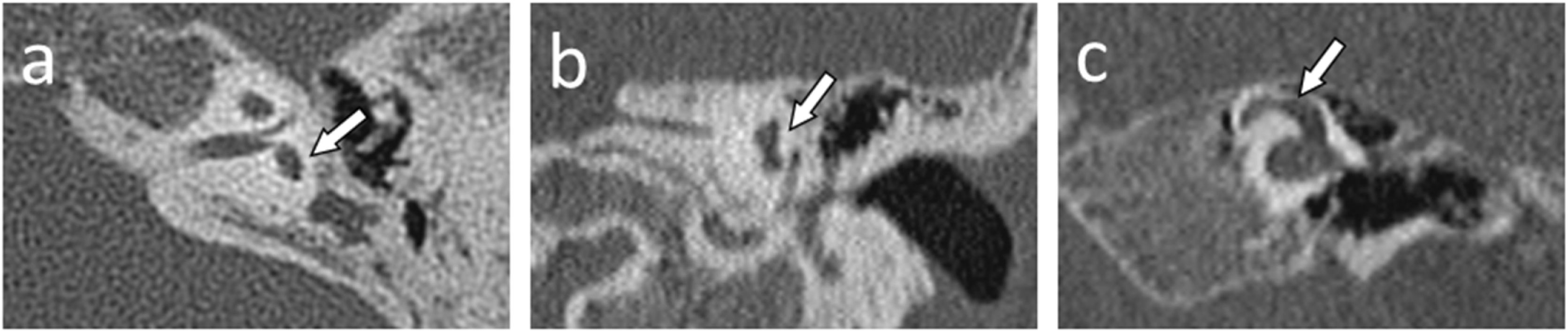 Detailed analysis of inner ear malformations in CHARGE syndrome ...