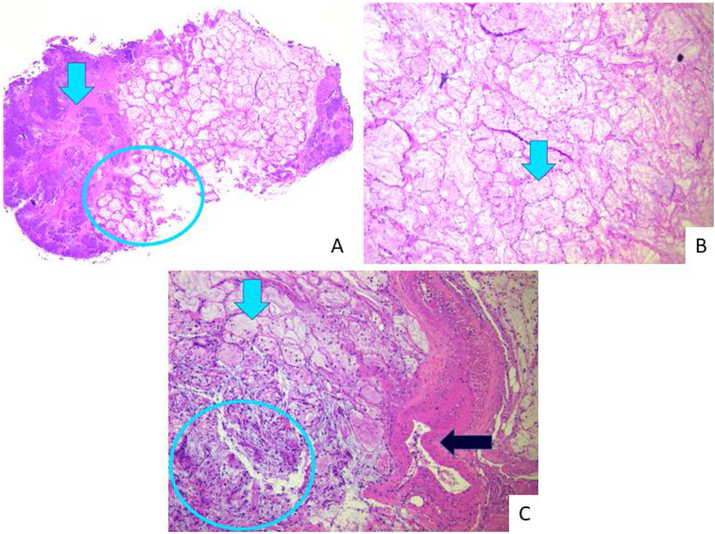 Necrotizing sialometaplasia on the hard palate after sequential induced ...