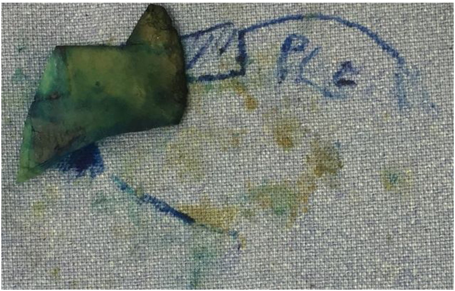 Modified extracorporeal septoplasty: prospective study | Brazilian ...