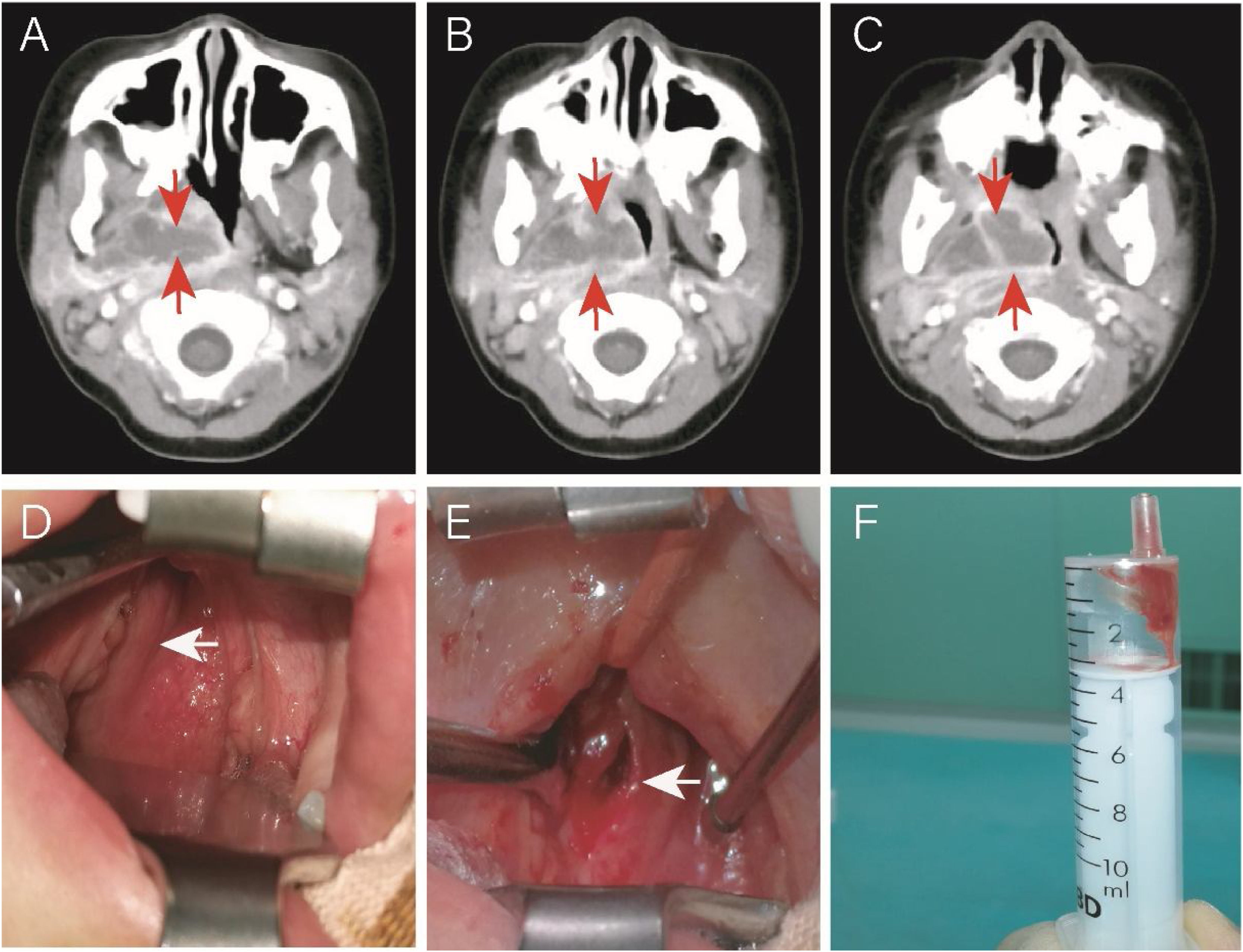 retropharyngeal abscess symptoms
