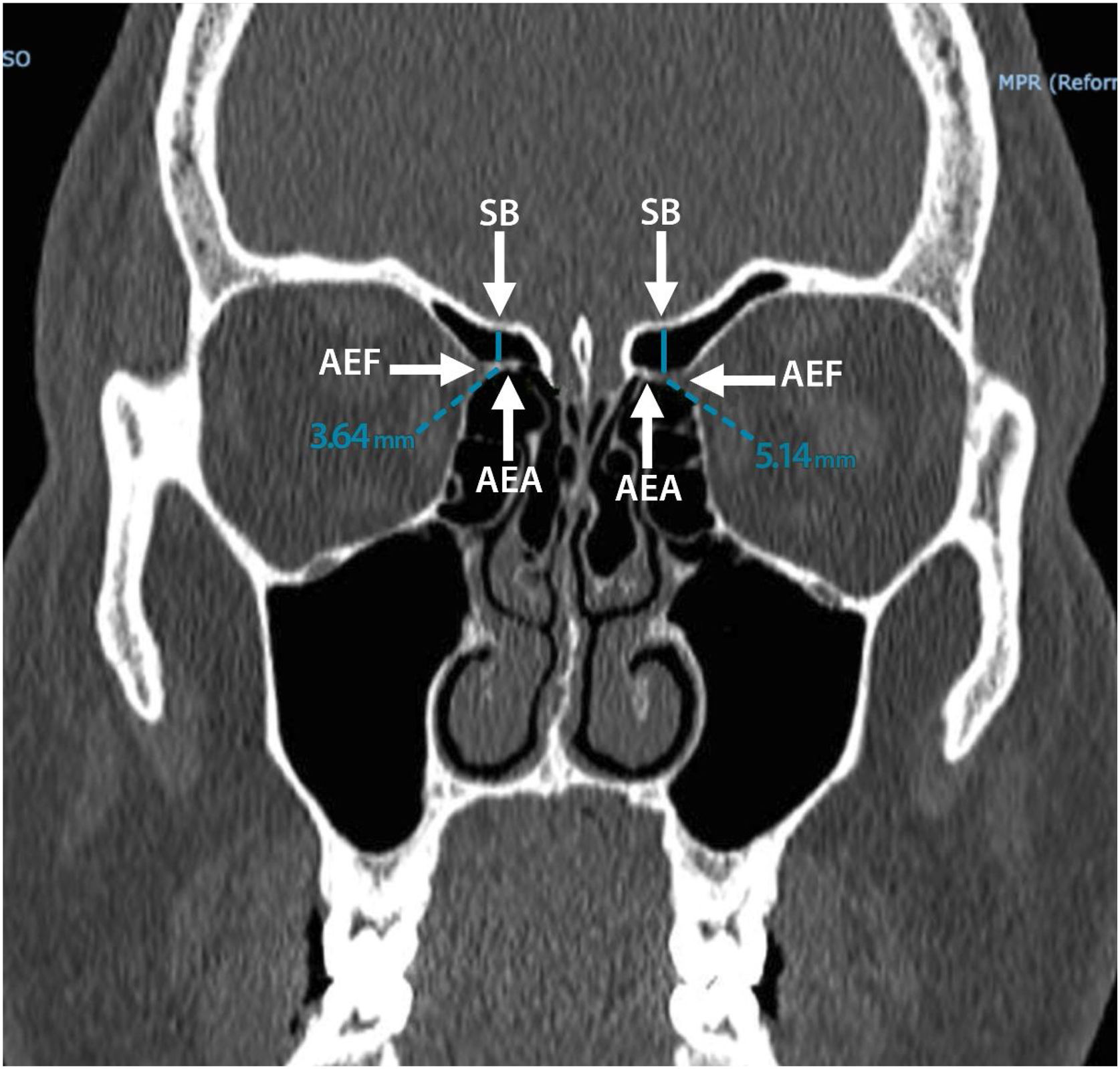 Limites Da Cavidade Nasal