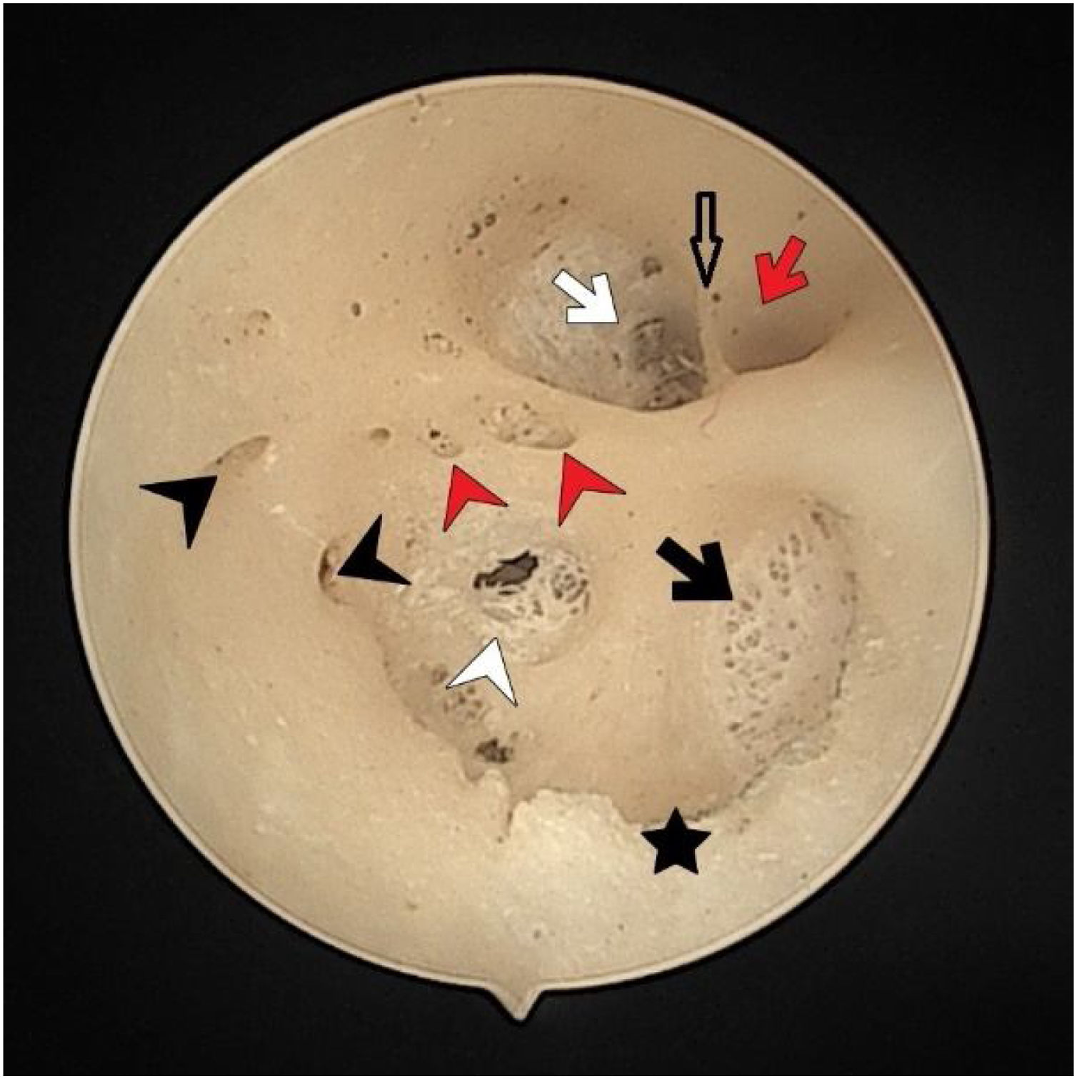 The variations of osseous structure of the ınternal acoustic canal: an ...