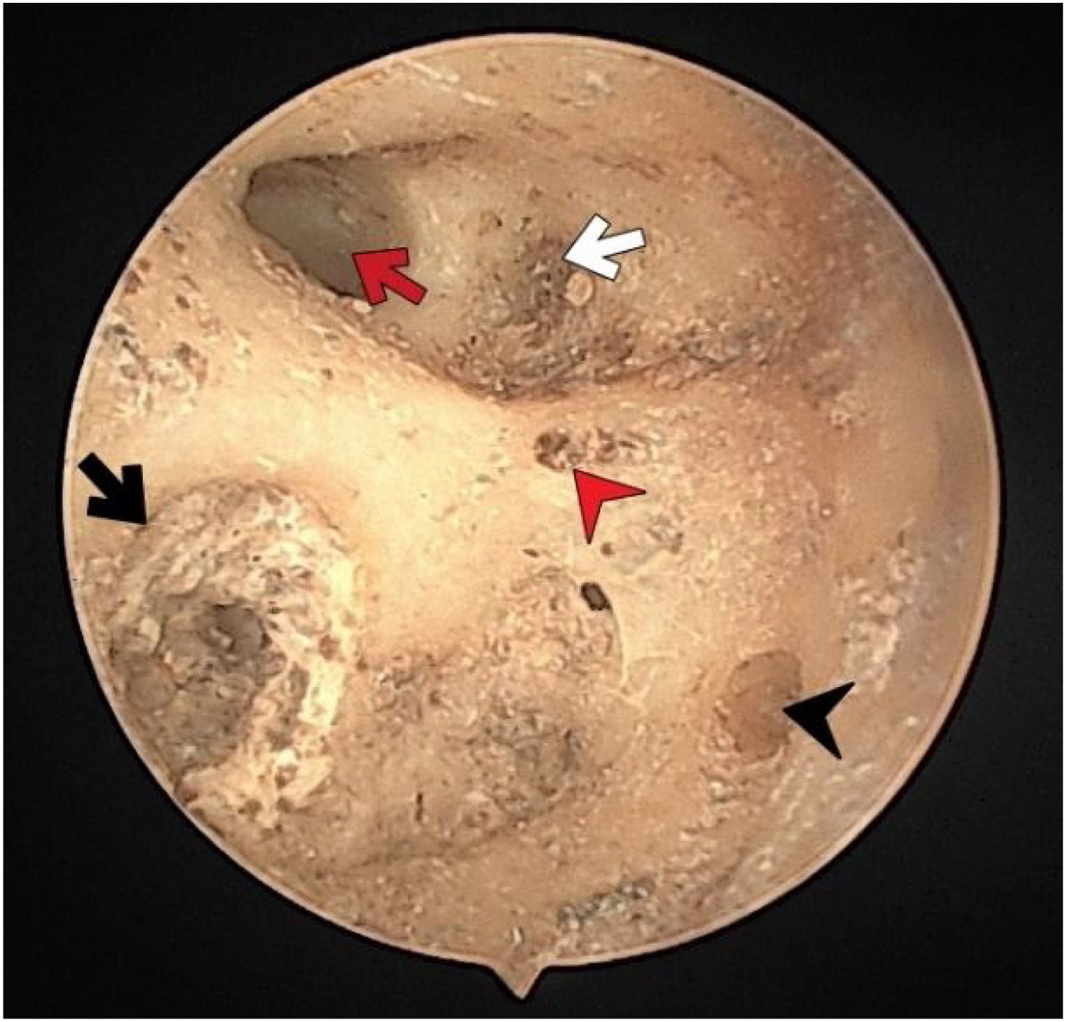 The variations of osseous structure of the ınternal acoustic canal: an ...