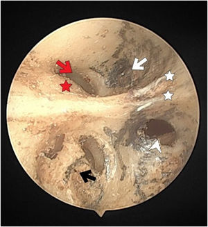 The variations of osseous structure of the ınternal acoustic canal: an ...