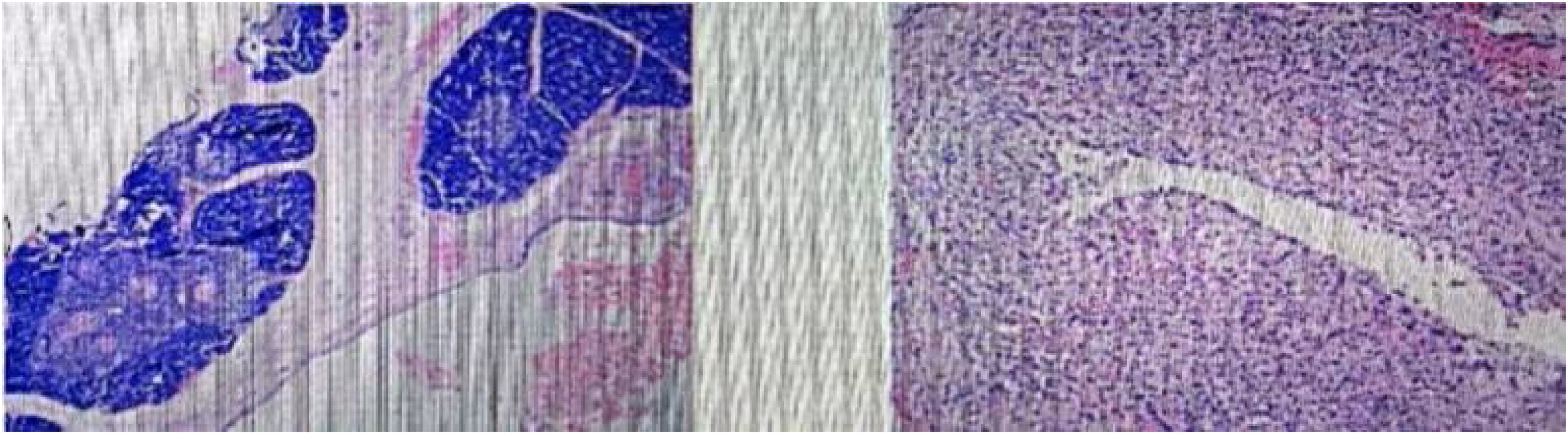 Ectopic cervical thymic cyst with thyroglossal duct cyst | Brazilian ...