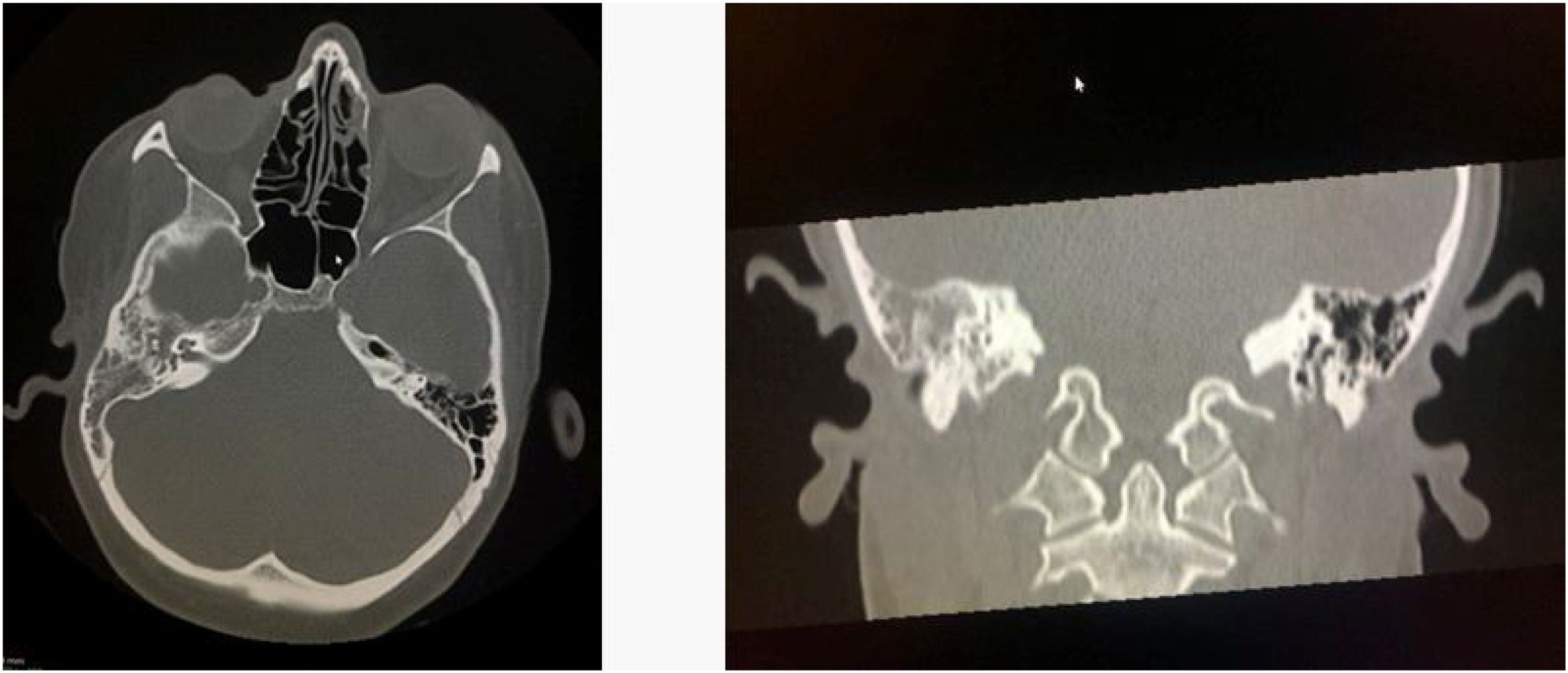 Neuroendocrine adenoma of middle ear: a case report and endoscopic ...