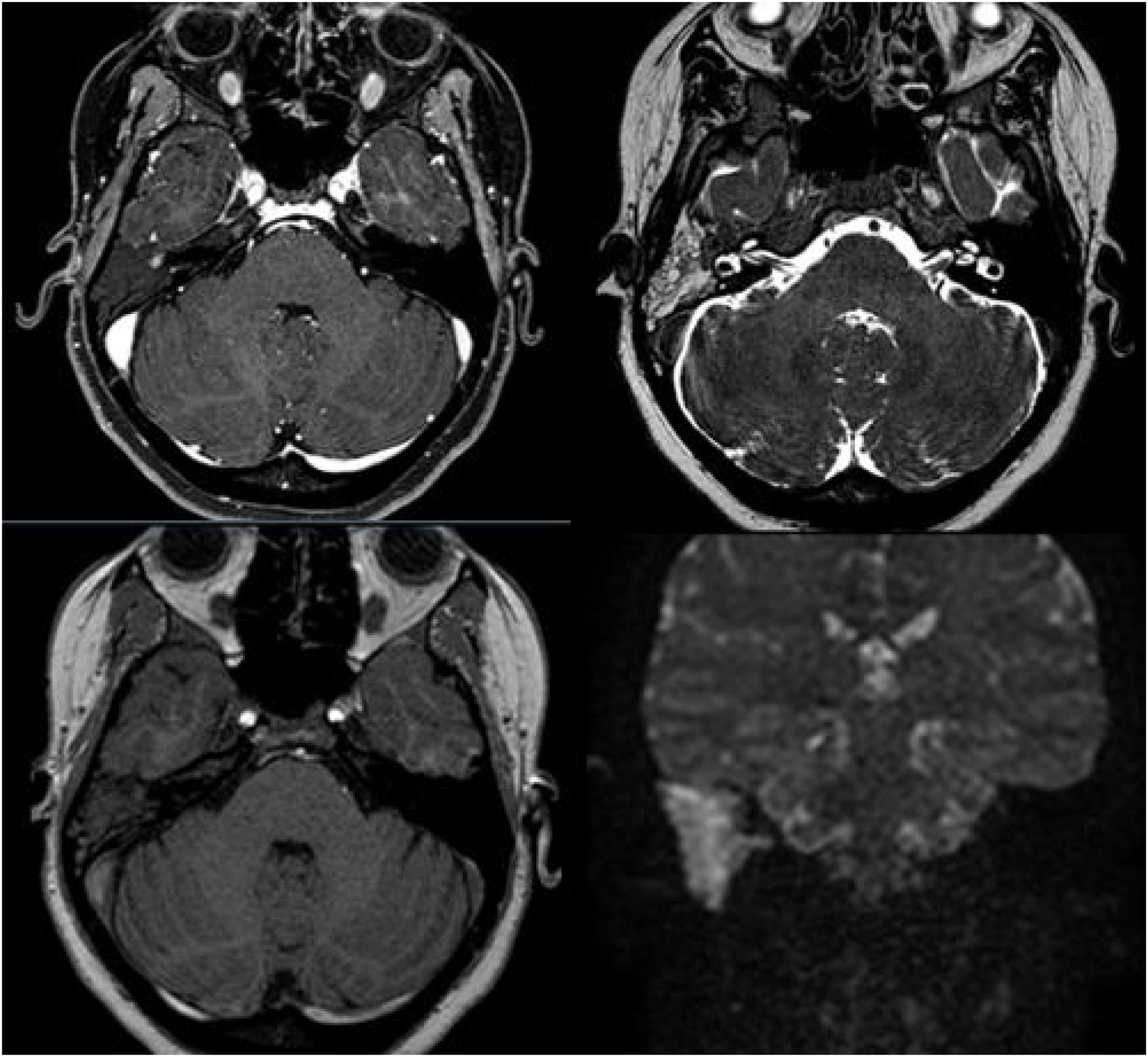 Neuroendocrine adenoma of middle ear: a case report and endoscopic ...
