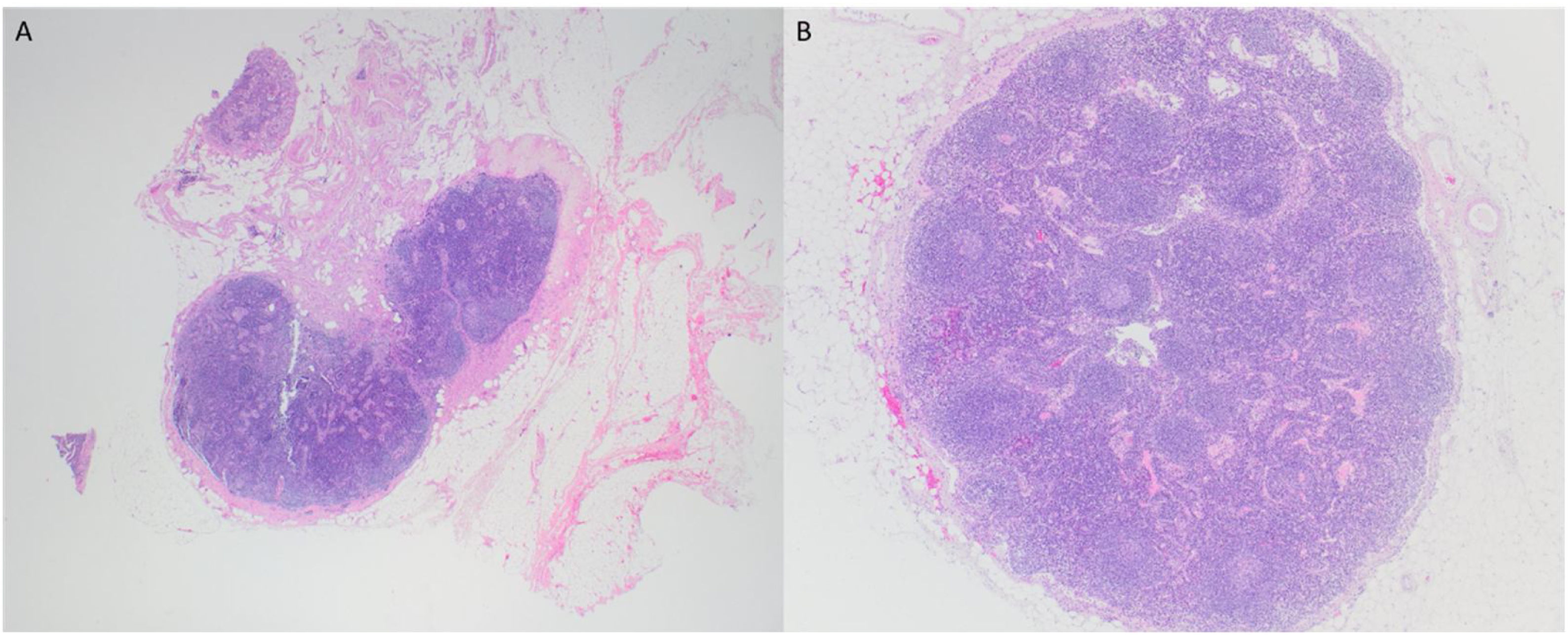 Internal jugular vein thrombosis caused by invasive pharyngeal cancer ...