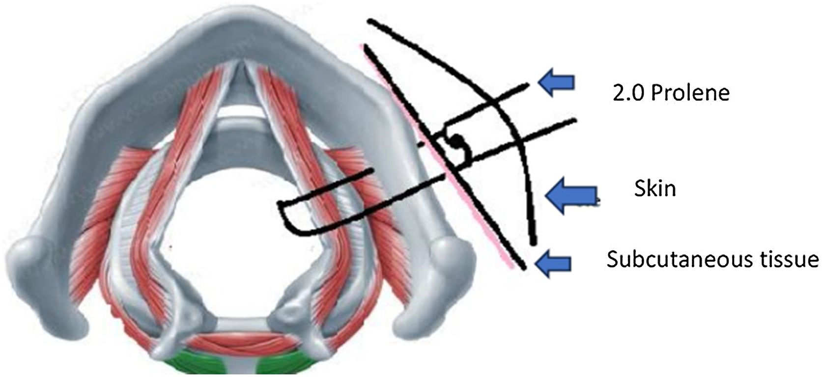 paramedian position of vocal folds