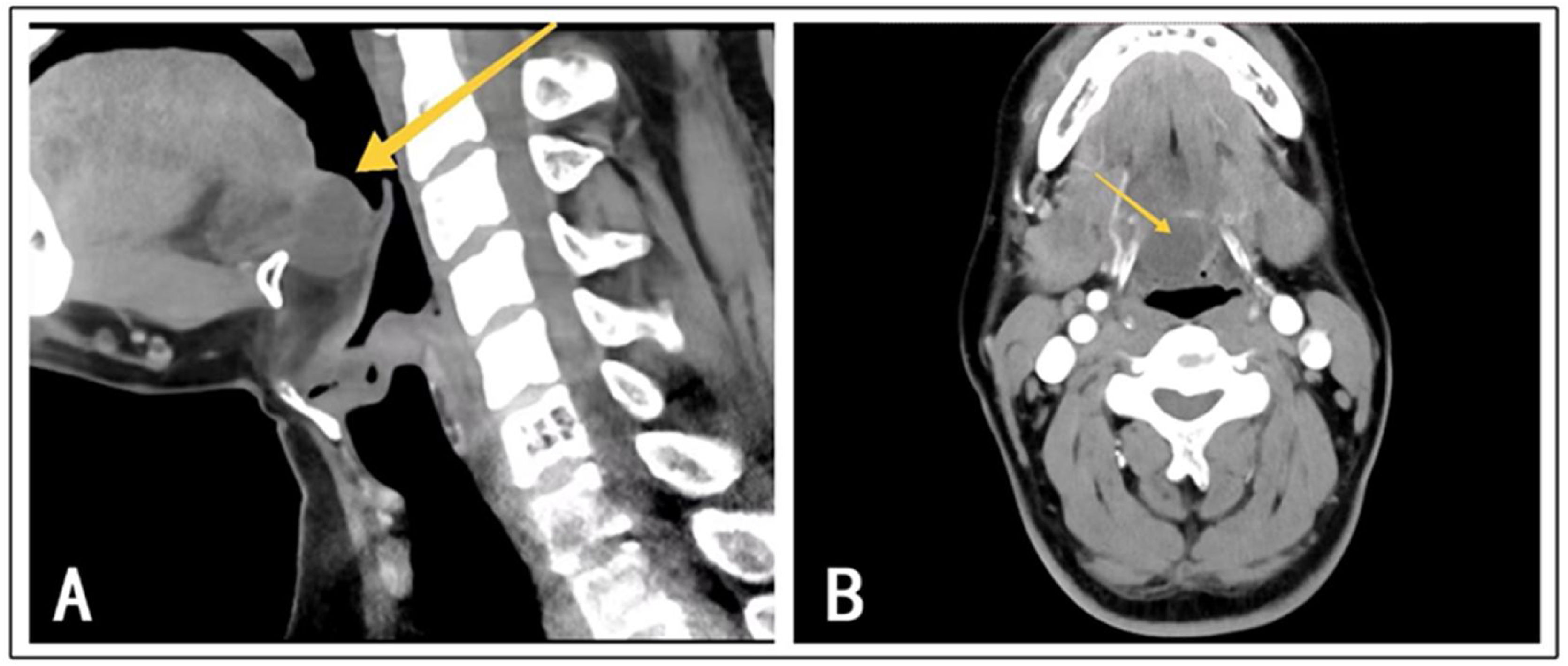 Comprehensive analysis and treatment of intraoral thyroglossal duct ...
