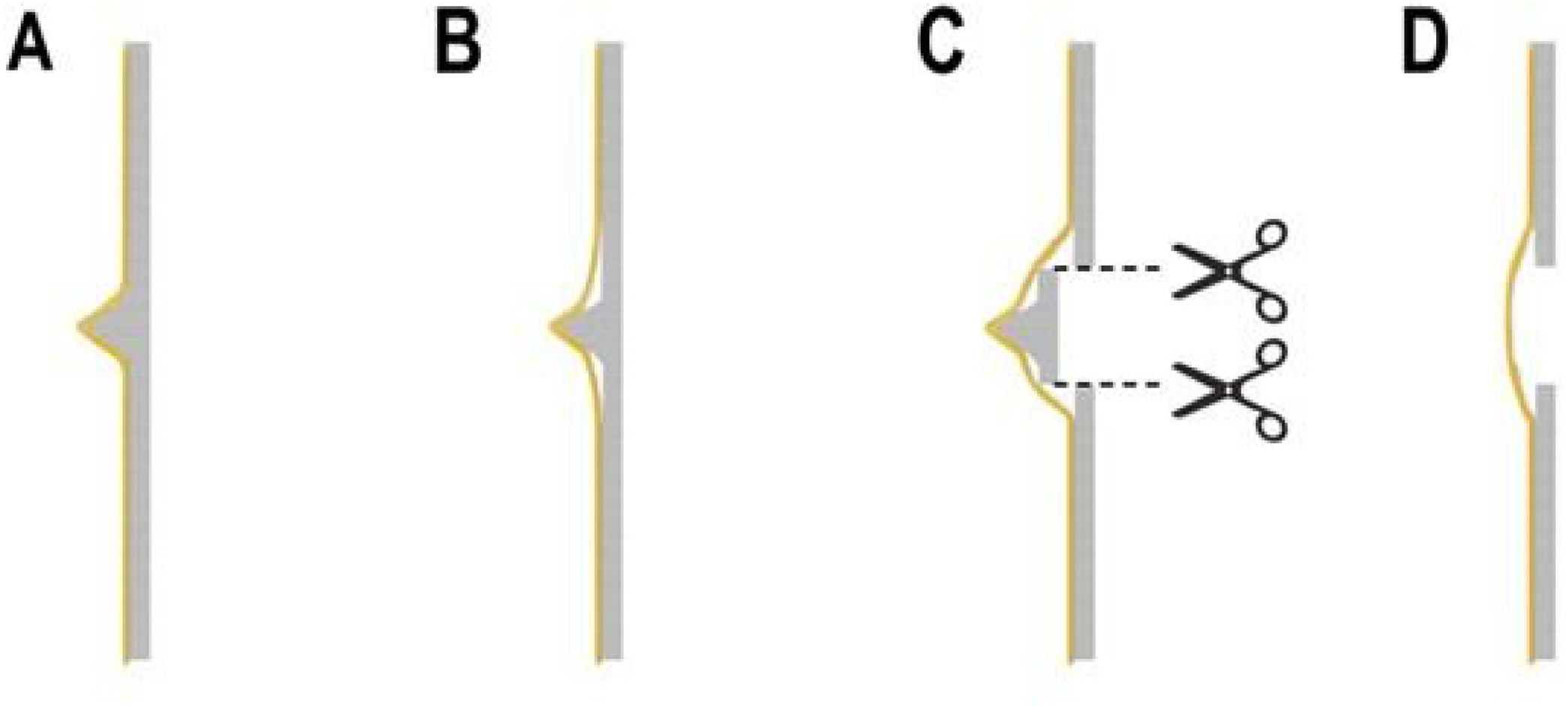 Reducing local tension to repair nasal septal deviation and spur ...
