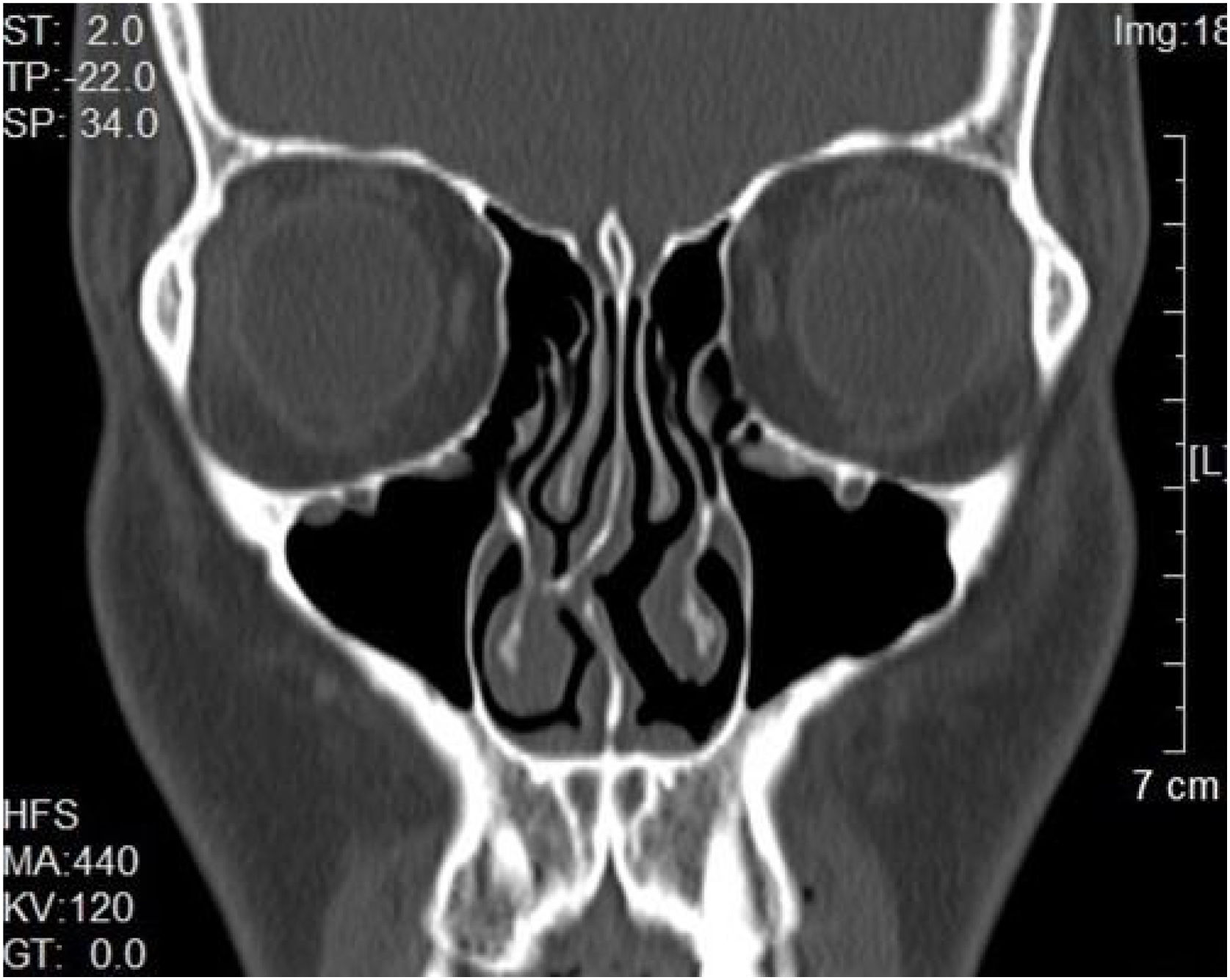 Reducing local tension to repair nasal septal deviation and spur ...