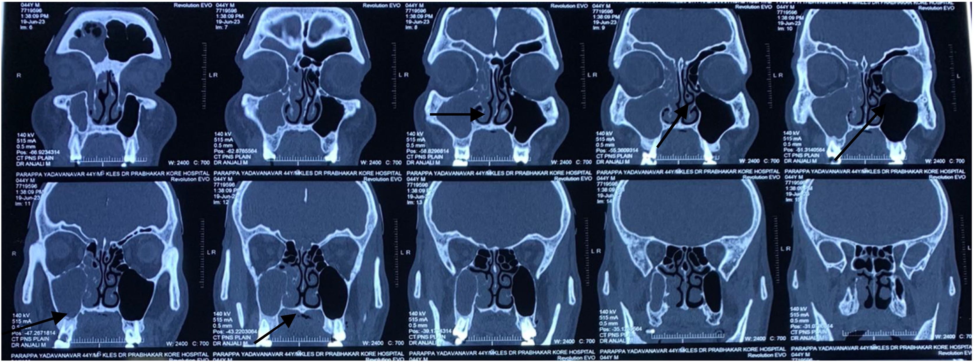 Immune reconstitution inflammatory syndrome mediated maxillary mucocele ...
