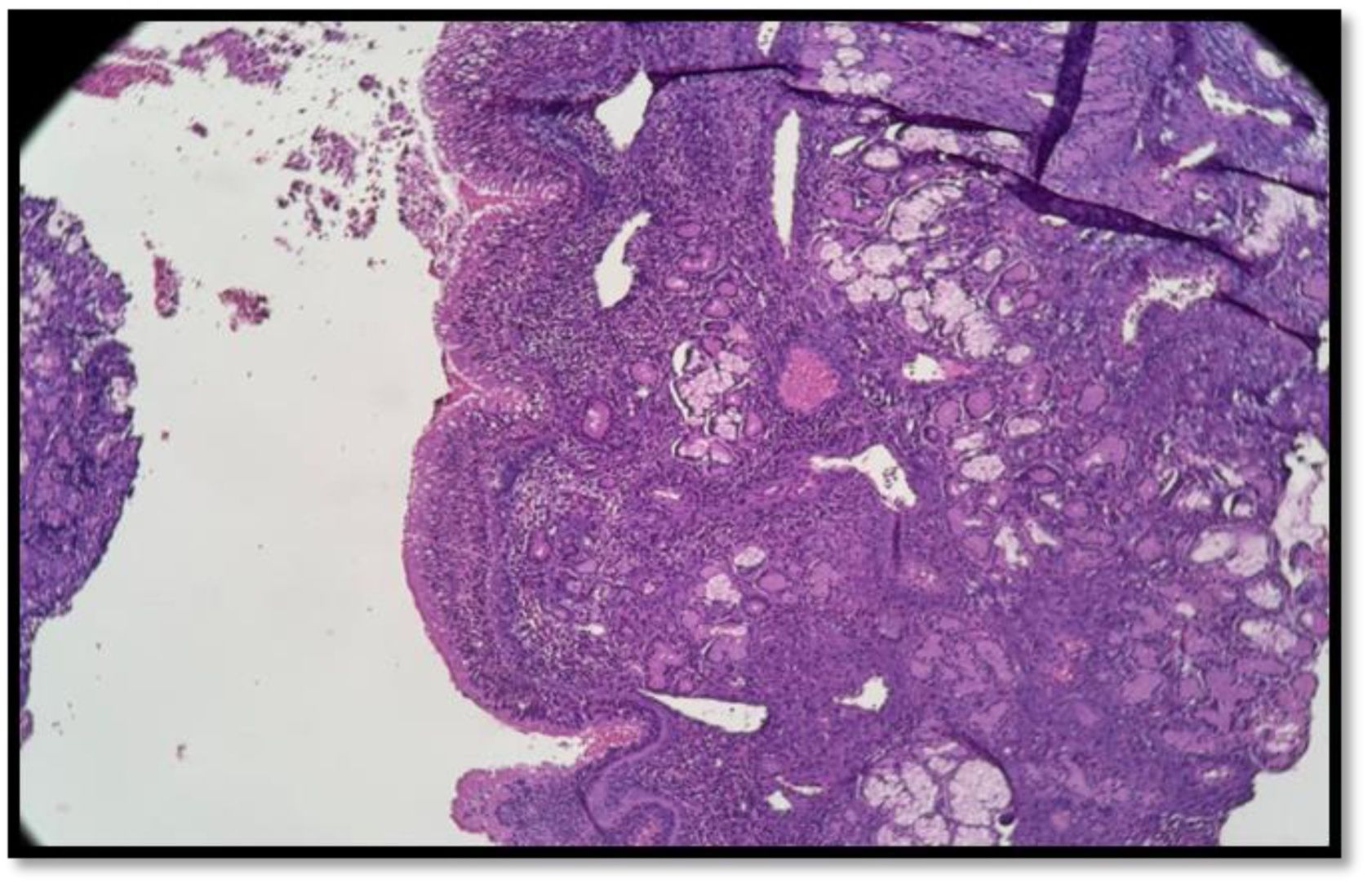 Immune reconstitution inflammatory syndrome mediated maxillary mucocele ...