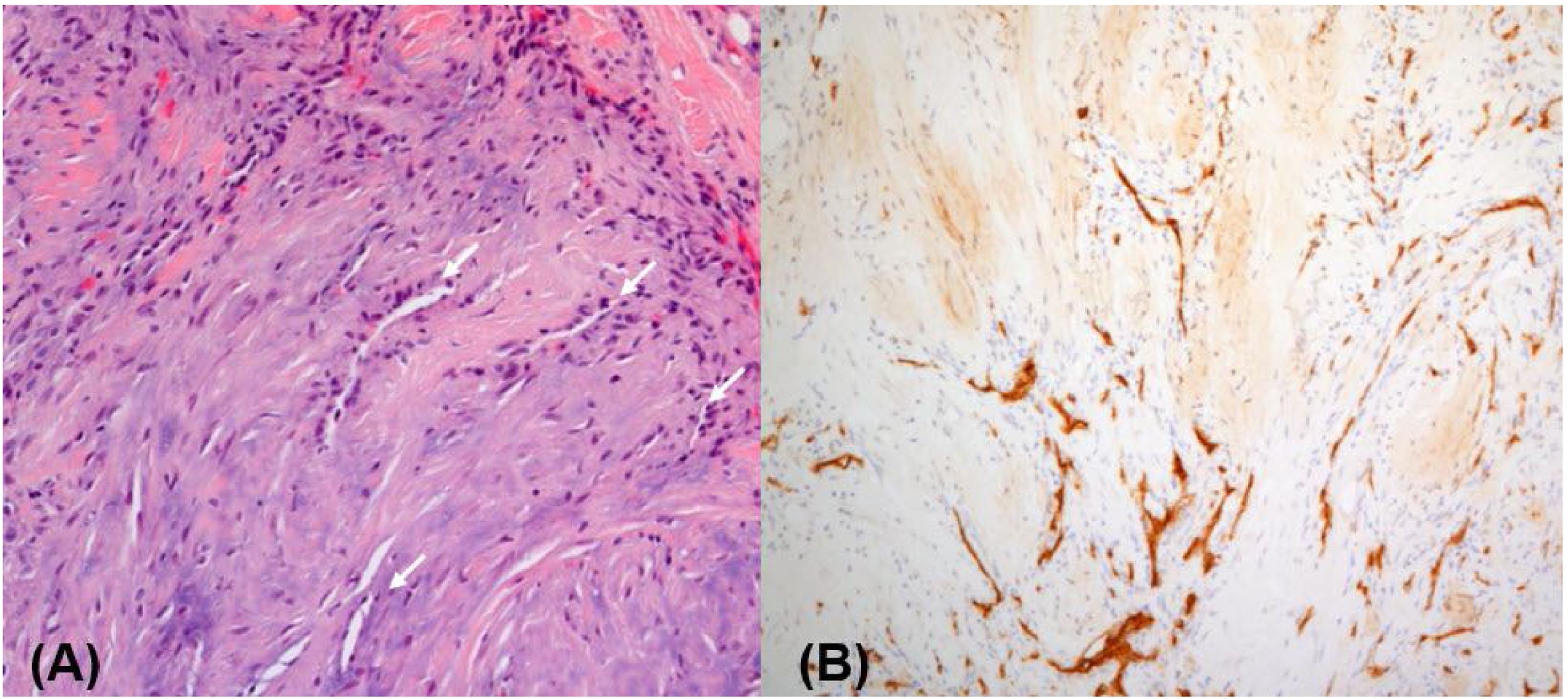 A case of extranasopharyngeal angiofibroma arising from nasal dorsum ...