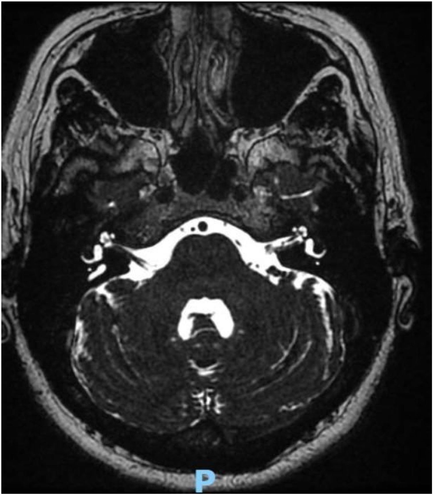 vestibular aqueduct function