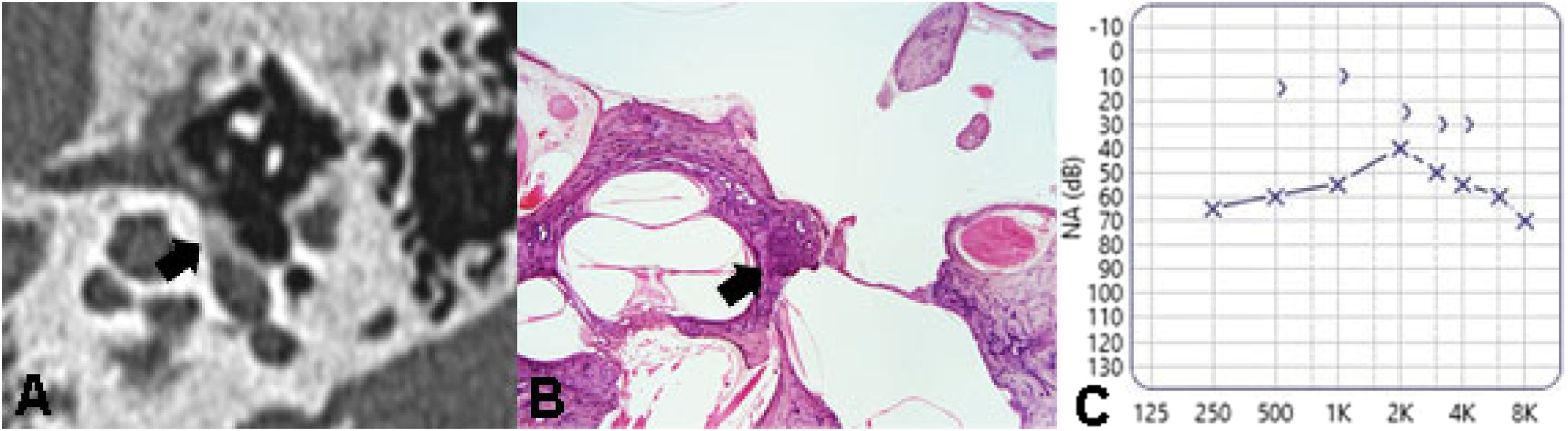 Sensorineural hearing loss and CT abnormalities in otosclerosis ...