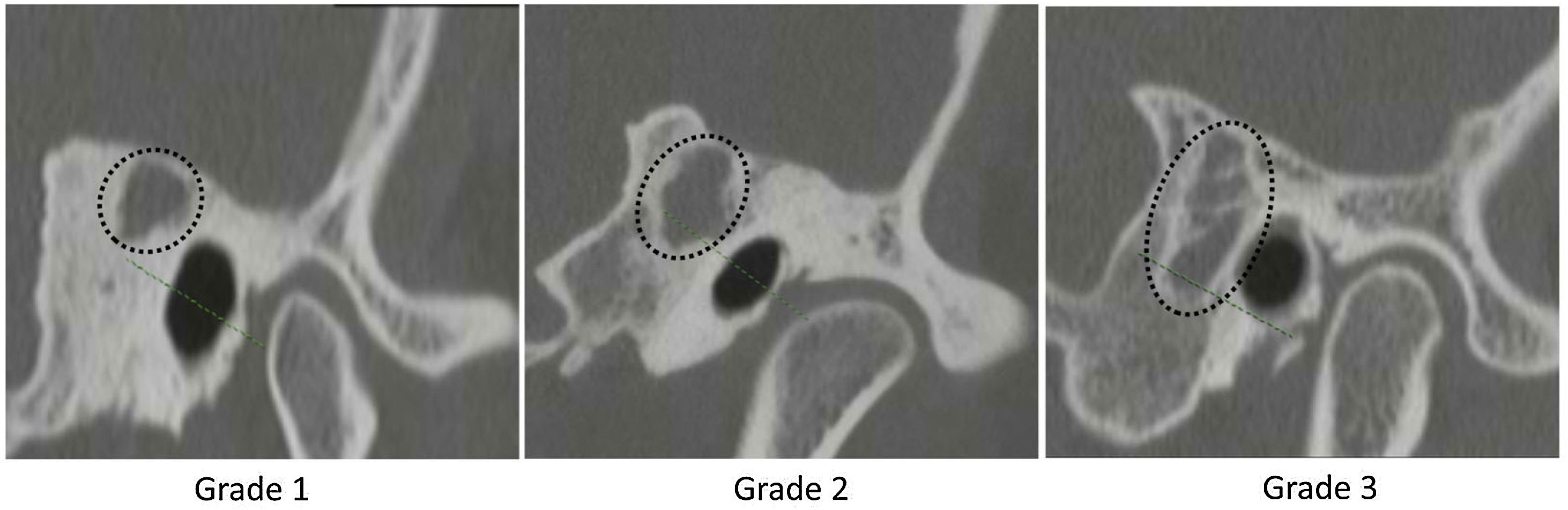 Concentrated growth factors promote epithelization in the mastoid ...