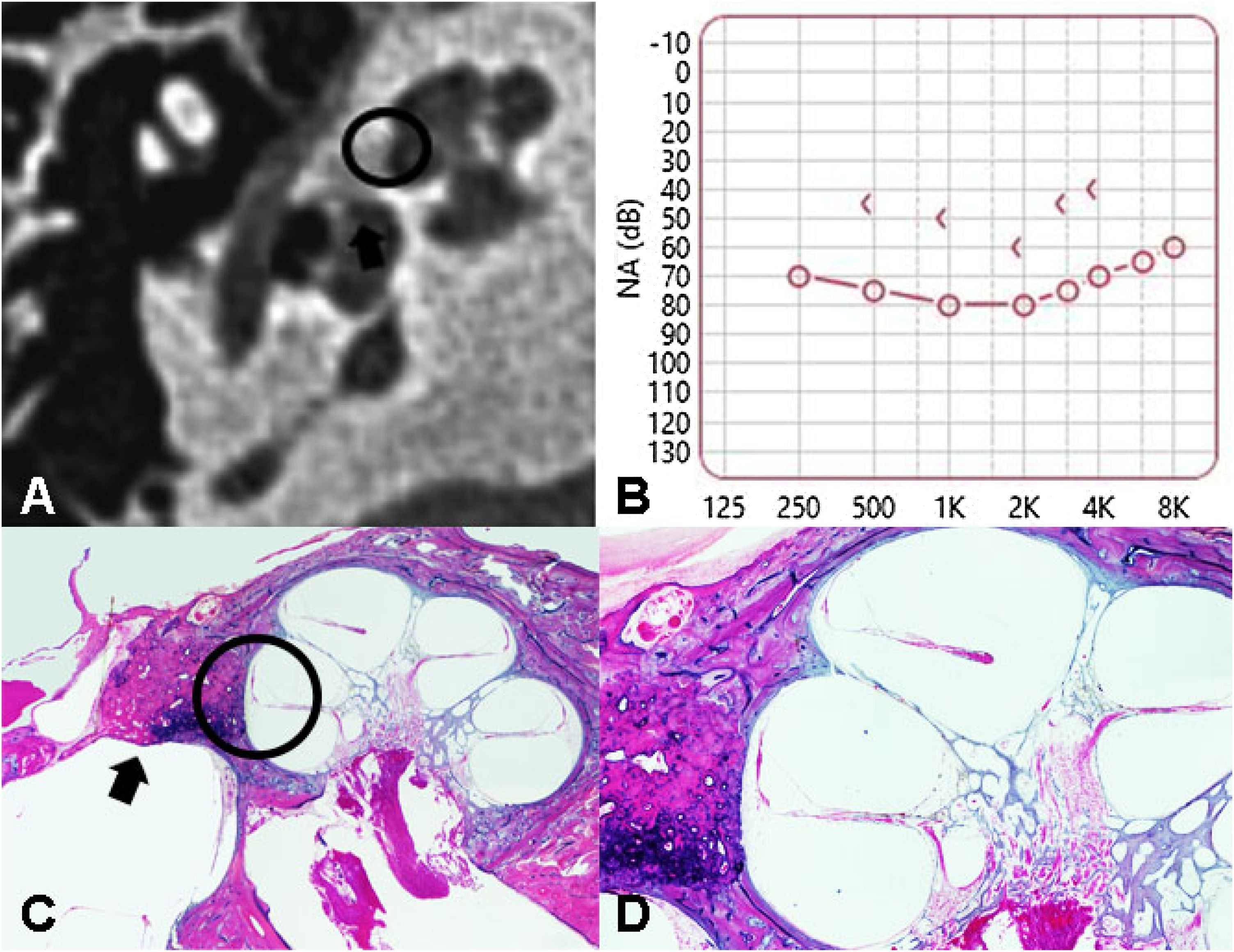 otosclerosis audiogram pattern