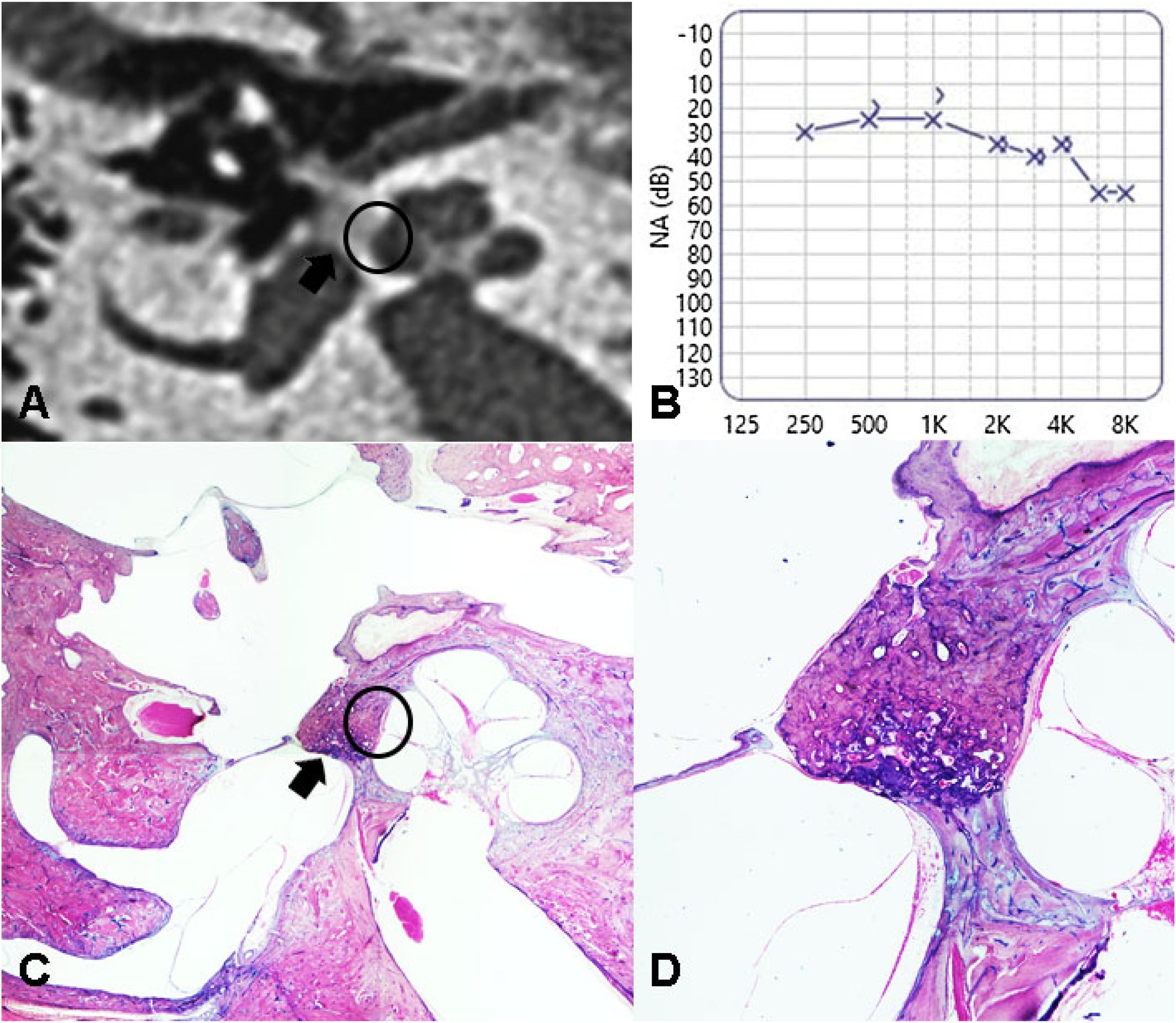 otosclerosis audiogram pattern
